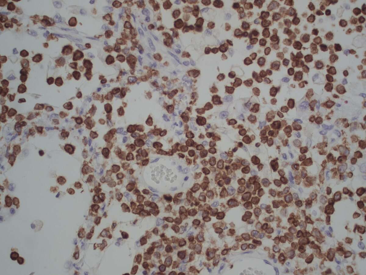 Pulmonary lymphoma | Case Study | Cytopath