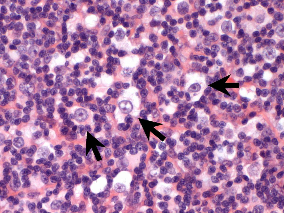 Hodgkin's-like lymphoma in a cat | Case Study | Cytopath