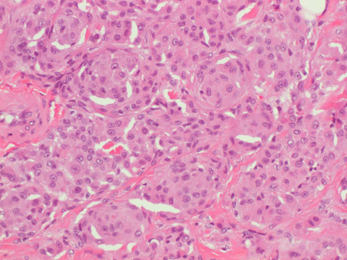 An orbital meningioma in a 10-year-old female Bull | Case Study | Cytopath