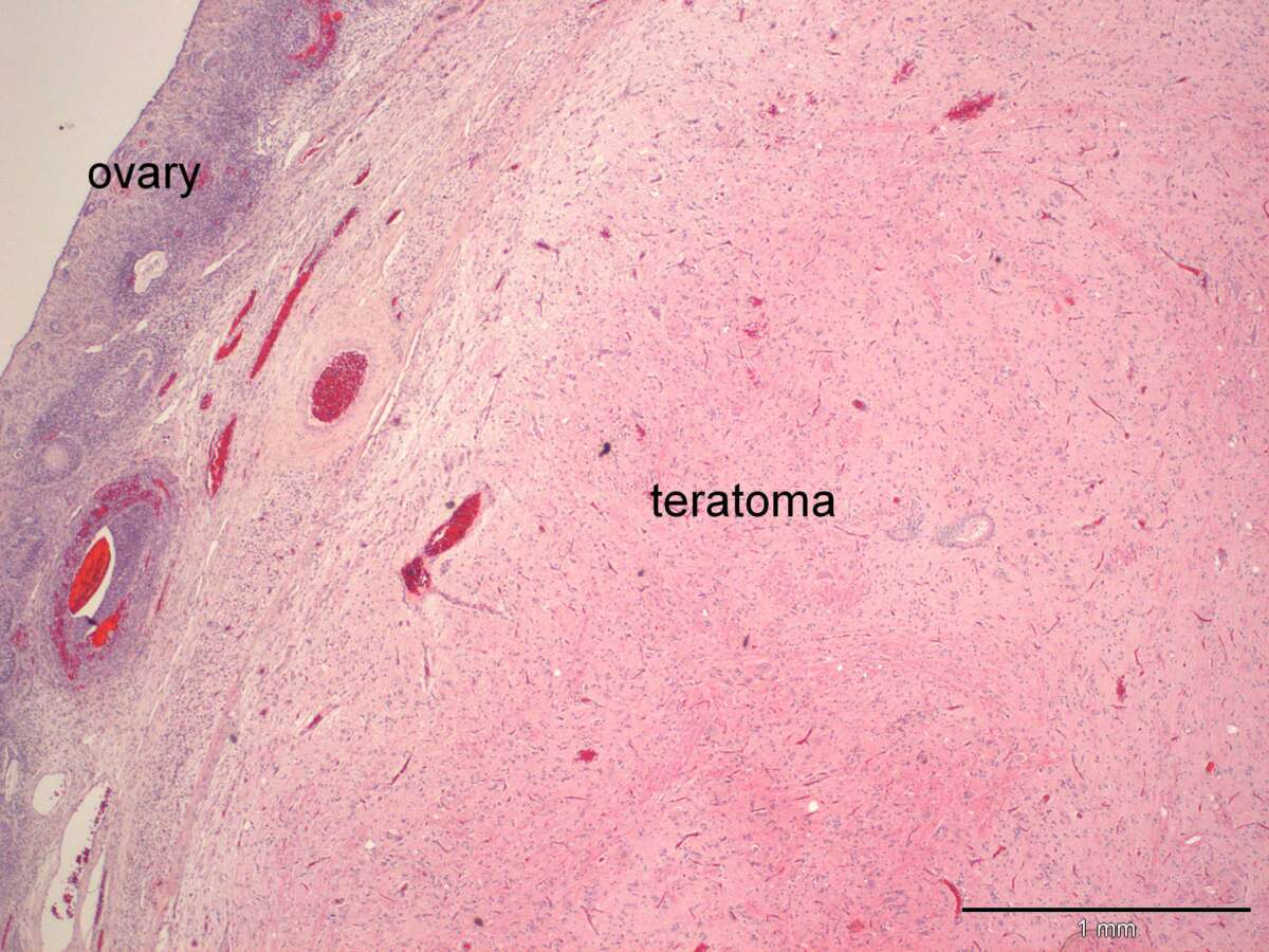 Ovarian teratoma | Case Study | Cytopath