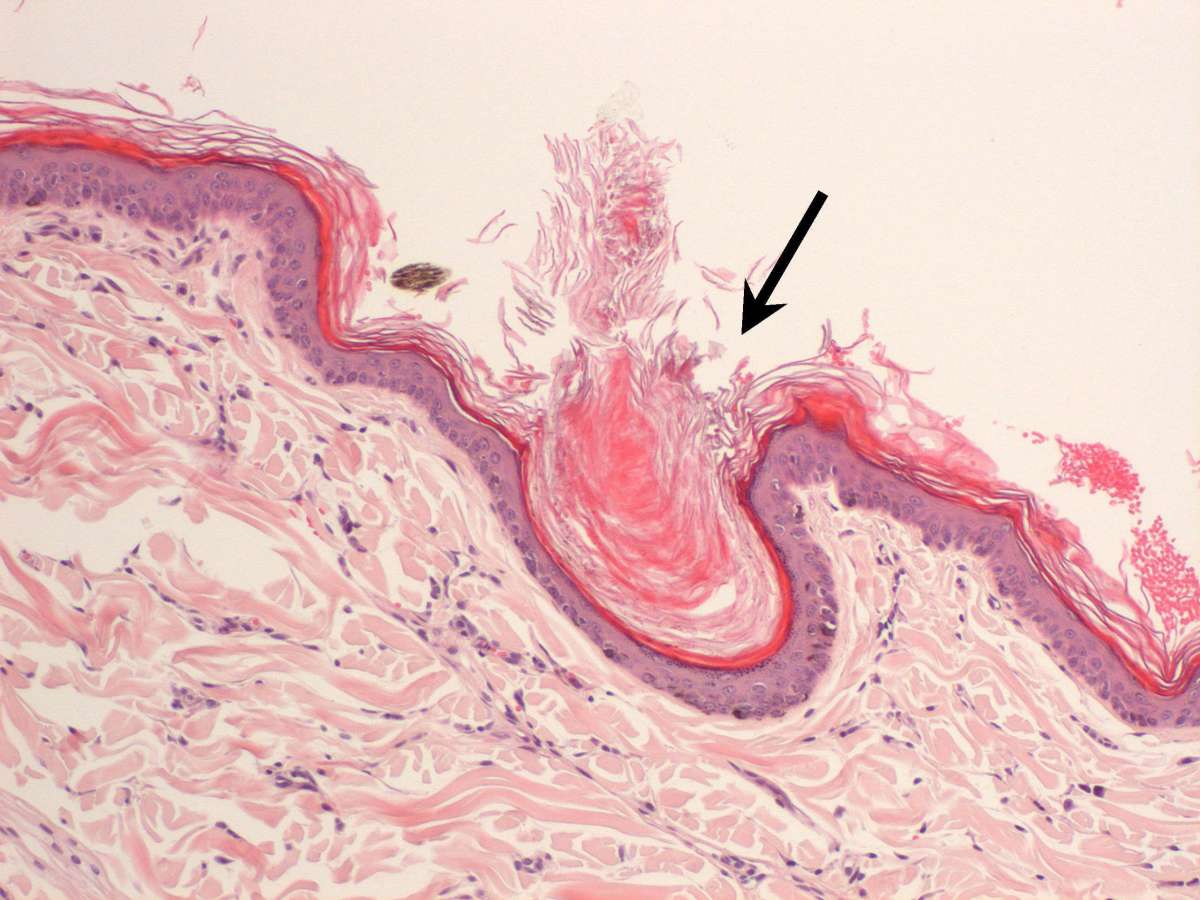 Sebaceous adenitis in a dog | Case Study | Cytopath