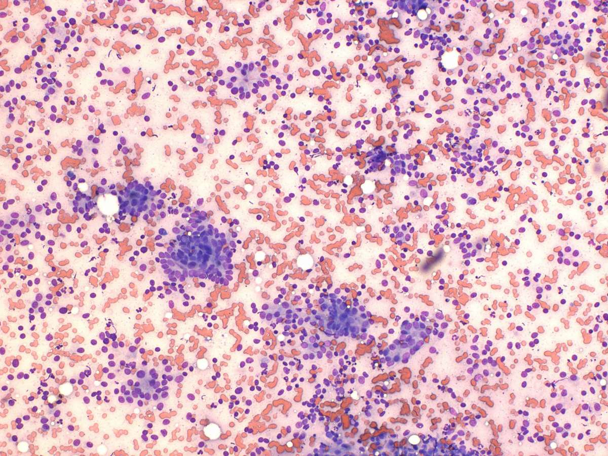 An enlarged sublumbar lymph node in a hypercalcaem | Case Study | Cytopath