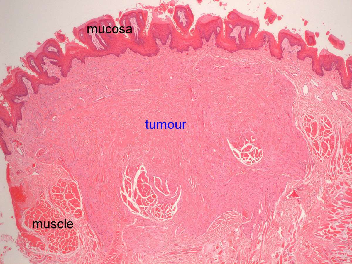 Lingual Granular Cell tumour in a dog | Case Study | Cytopath