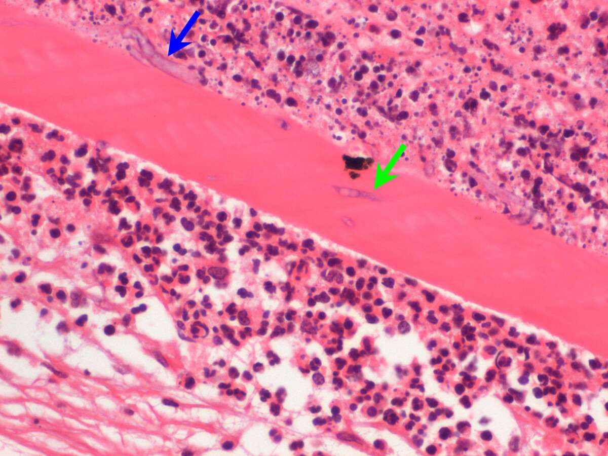 Fungal keratitis and secondary endophthalmitis in | Case Study | Cytopath
