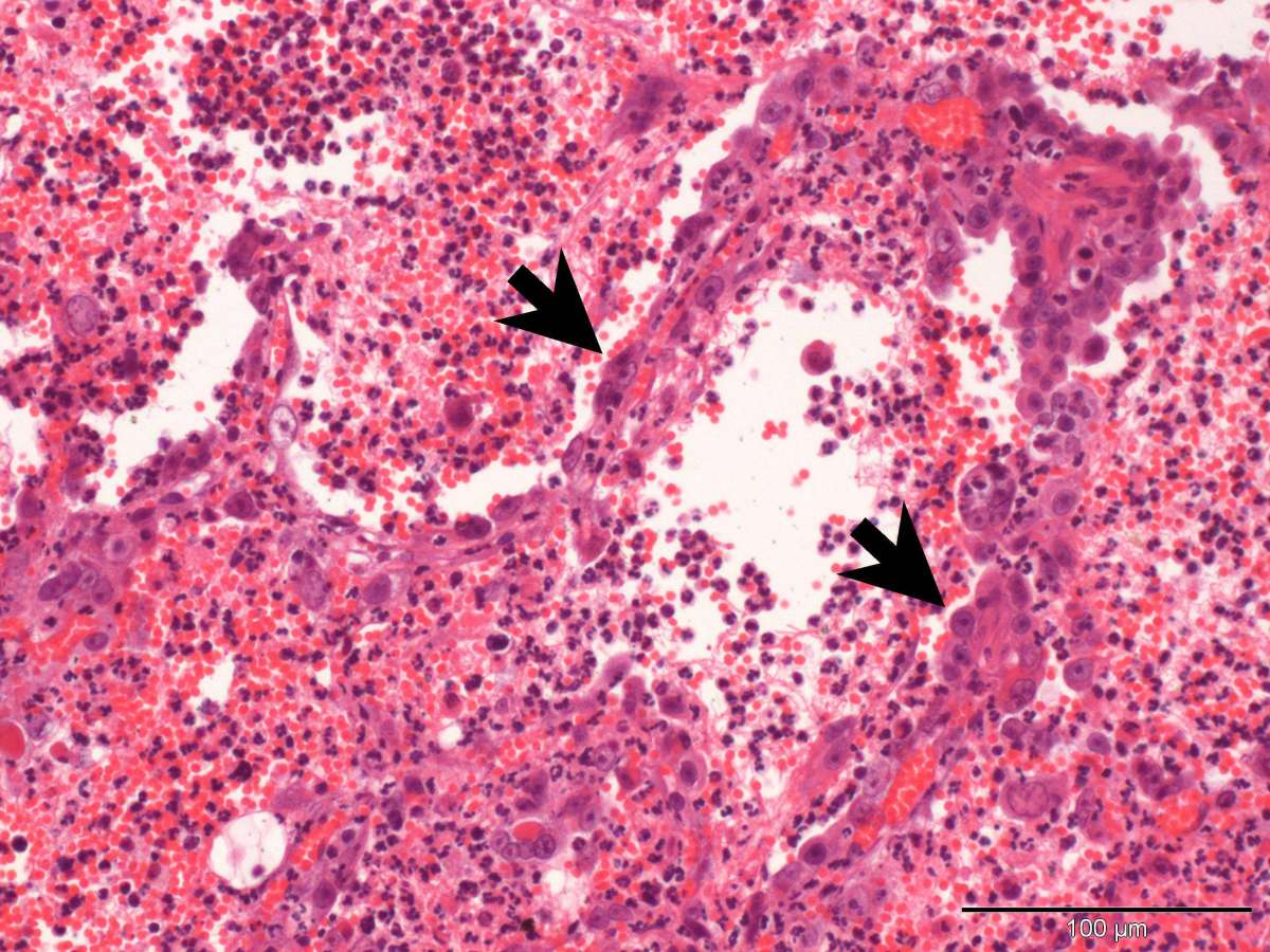 Autumn has arrived - fatal cowpox infection in a c | Case Study | Cytopath