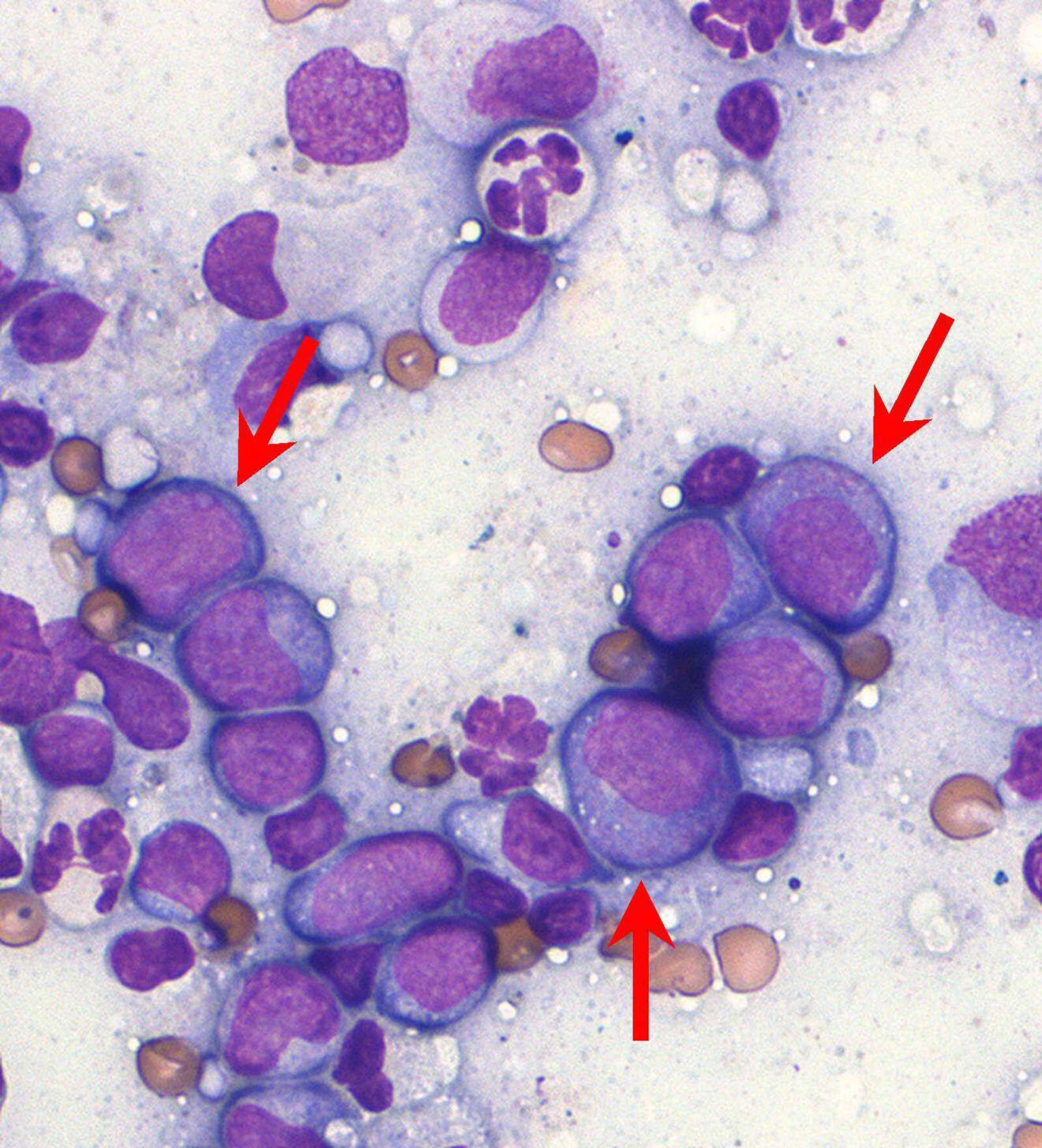 Myeloid leukaemia with lymph node invasion in a do | Case Study | Cytopath