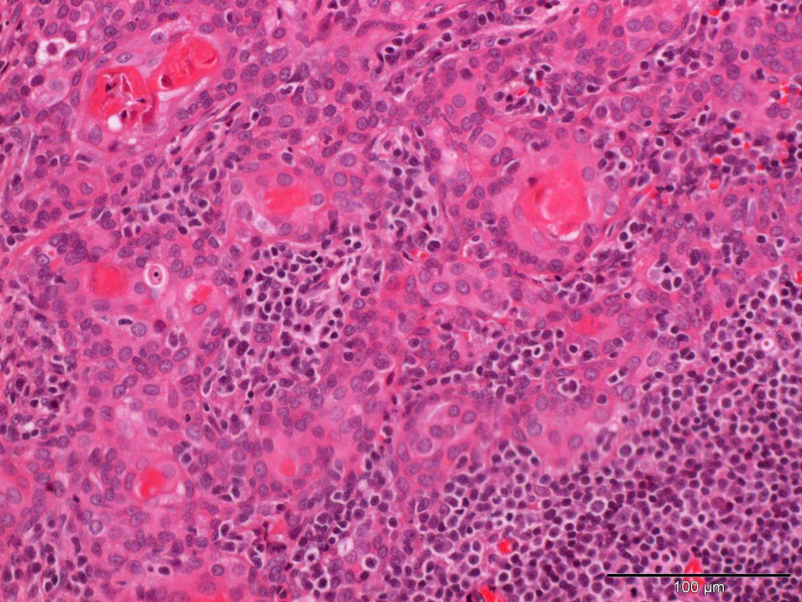 A tonsillar squamous cell carcinoma in a 6-year-ol | Case Study | Cytopath