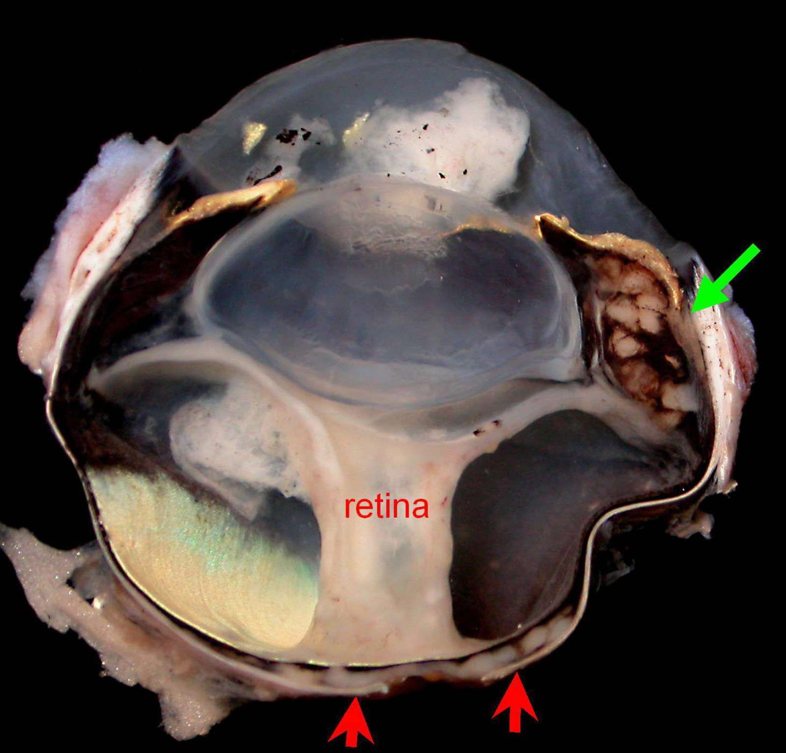 Mycobacterial infection in an eye | Case Study | Cytopath