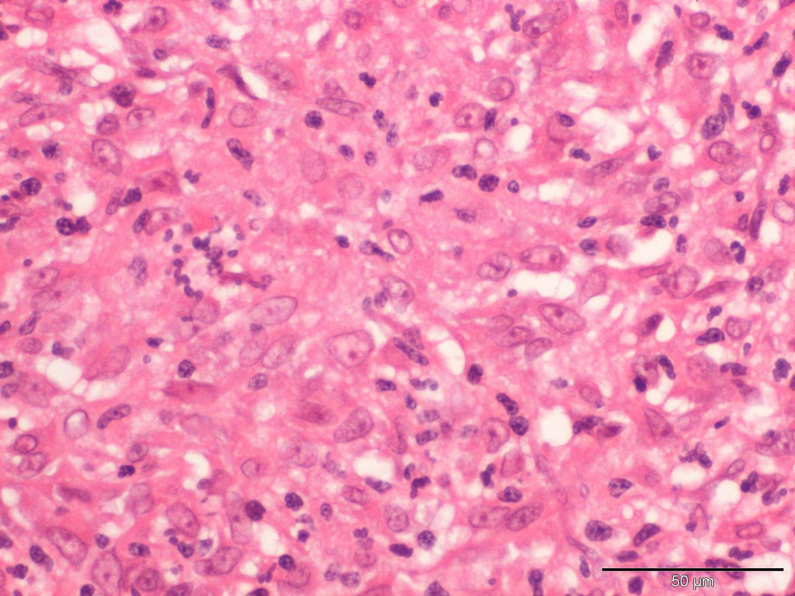 Mycobacterial infection in an eye | Case Study | Cytopath