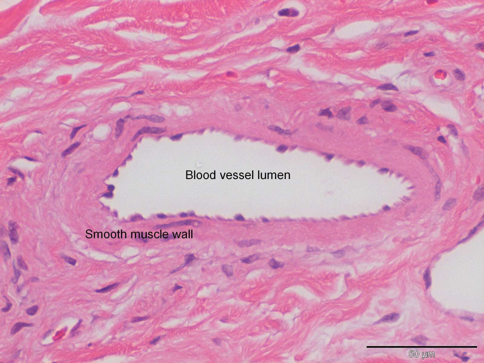 Proliferative thrombovascular necrosis of the pinn | Case Study | Cytopath