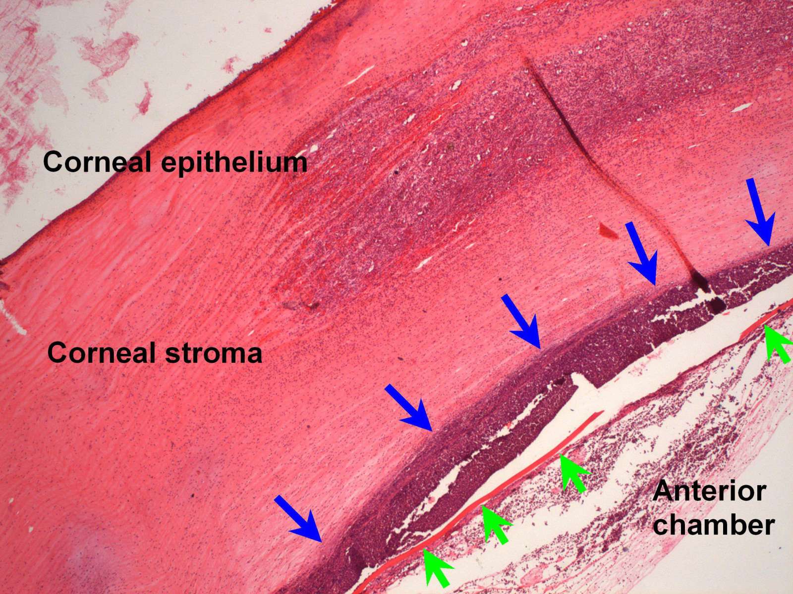 Fungal keratitis and secondary endophthalmitis in | Case Study | Cytopath