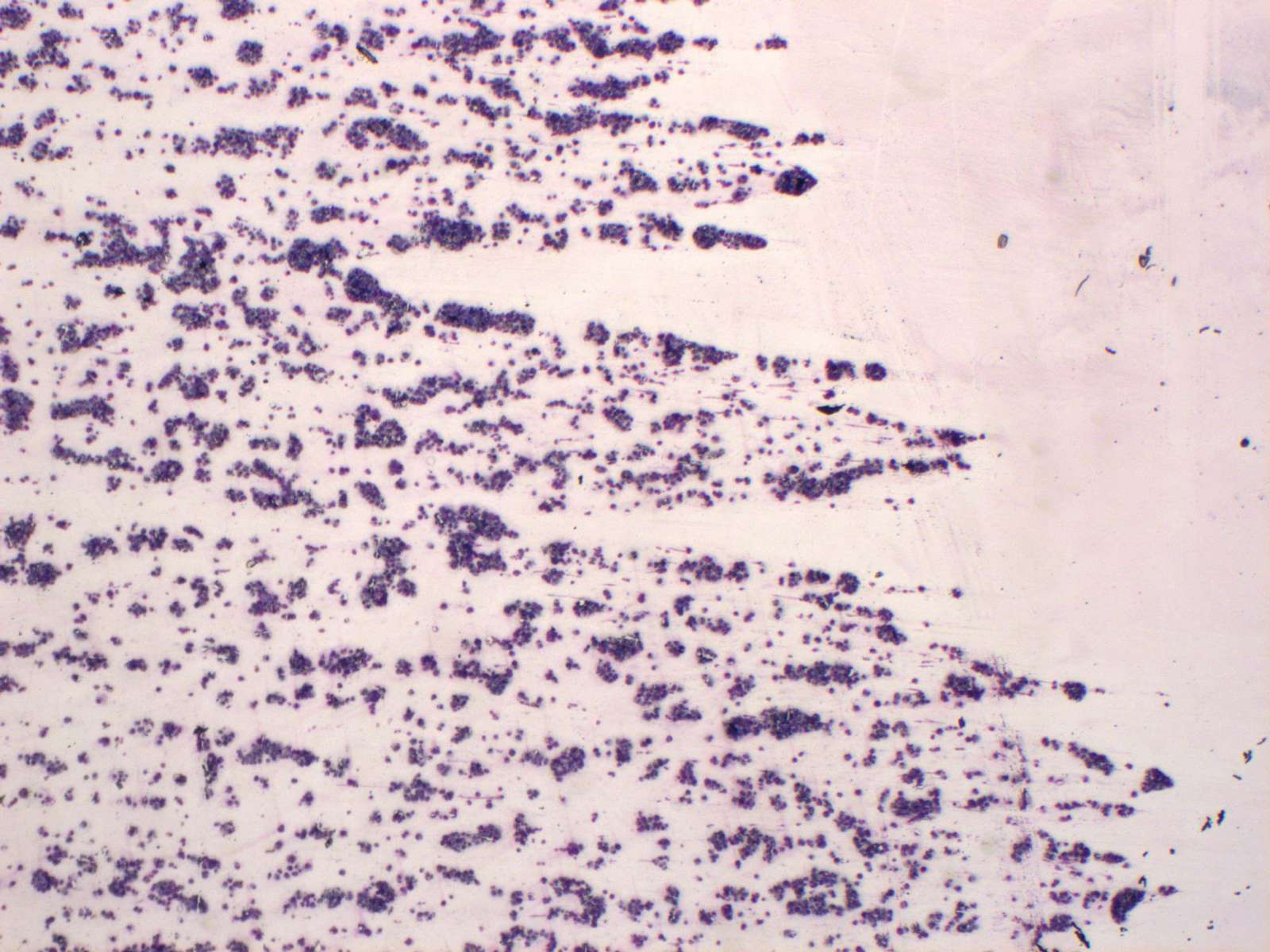 Neoplastic pleural effusion in a dog | Case Study | Cytopath