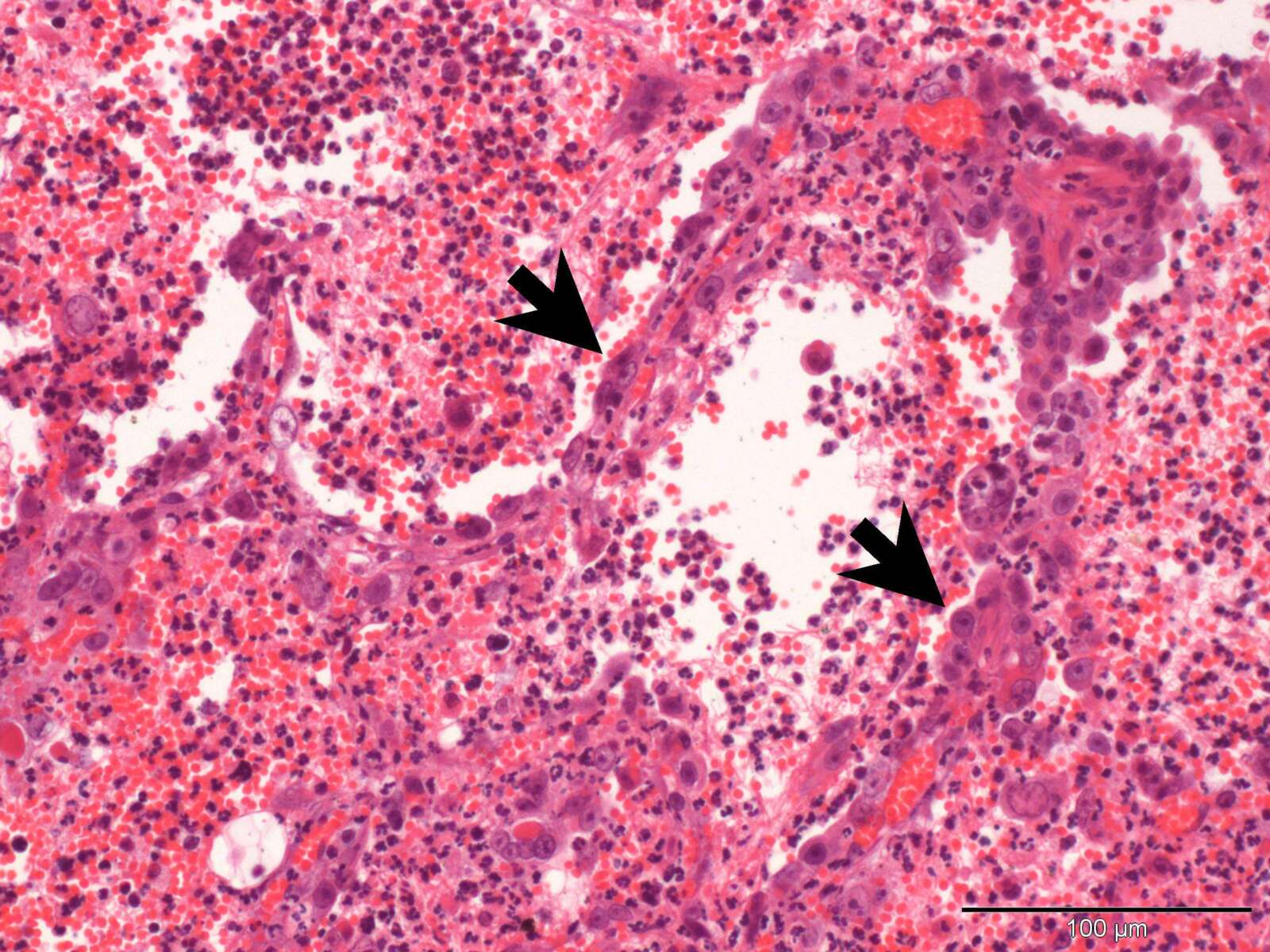 Autumn has arrived - fatal cowpox infection in a c | Case Study | Cytopath