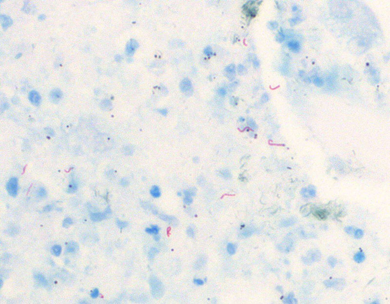 Mycobacterial infection in an eye | Case Study | Cytopath