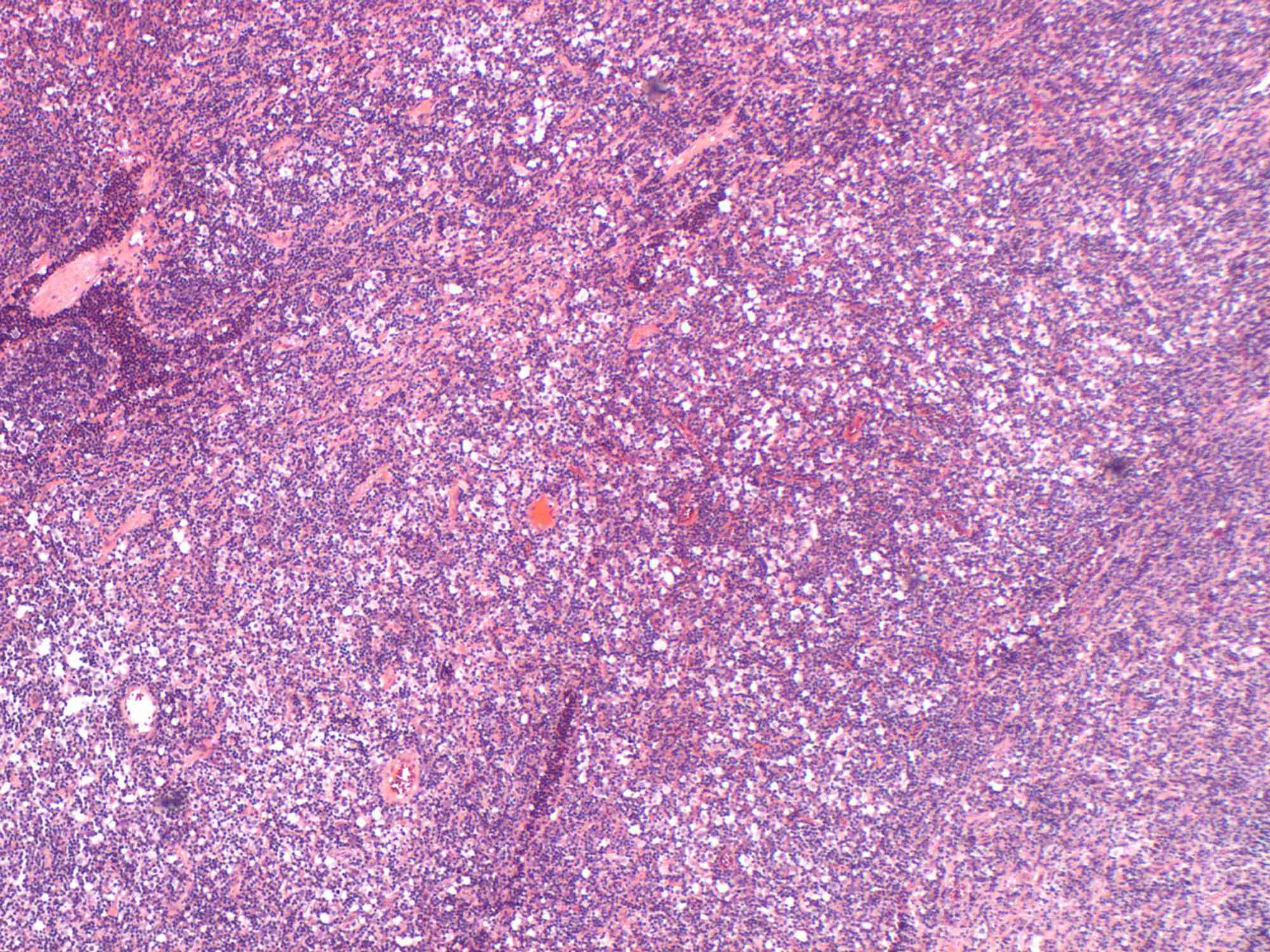 Hodgkin's-like lymphoma in a cat | Case Study | Cytopath
