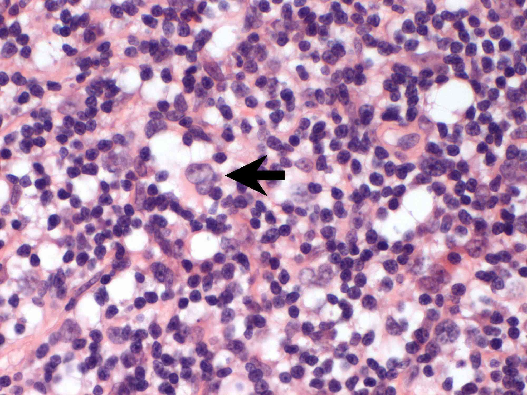 Hodgkin's-like lymphoma in a cat | Case Study | Cytopath