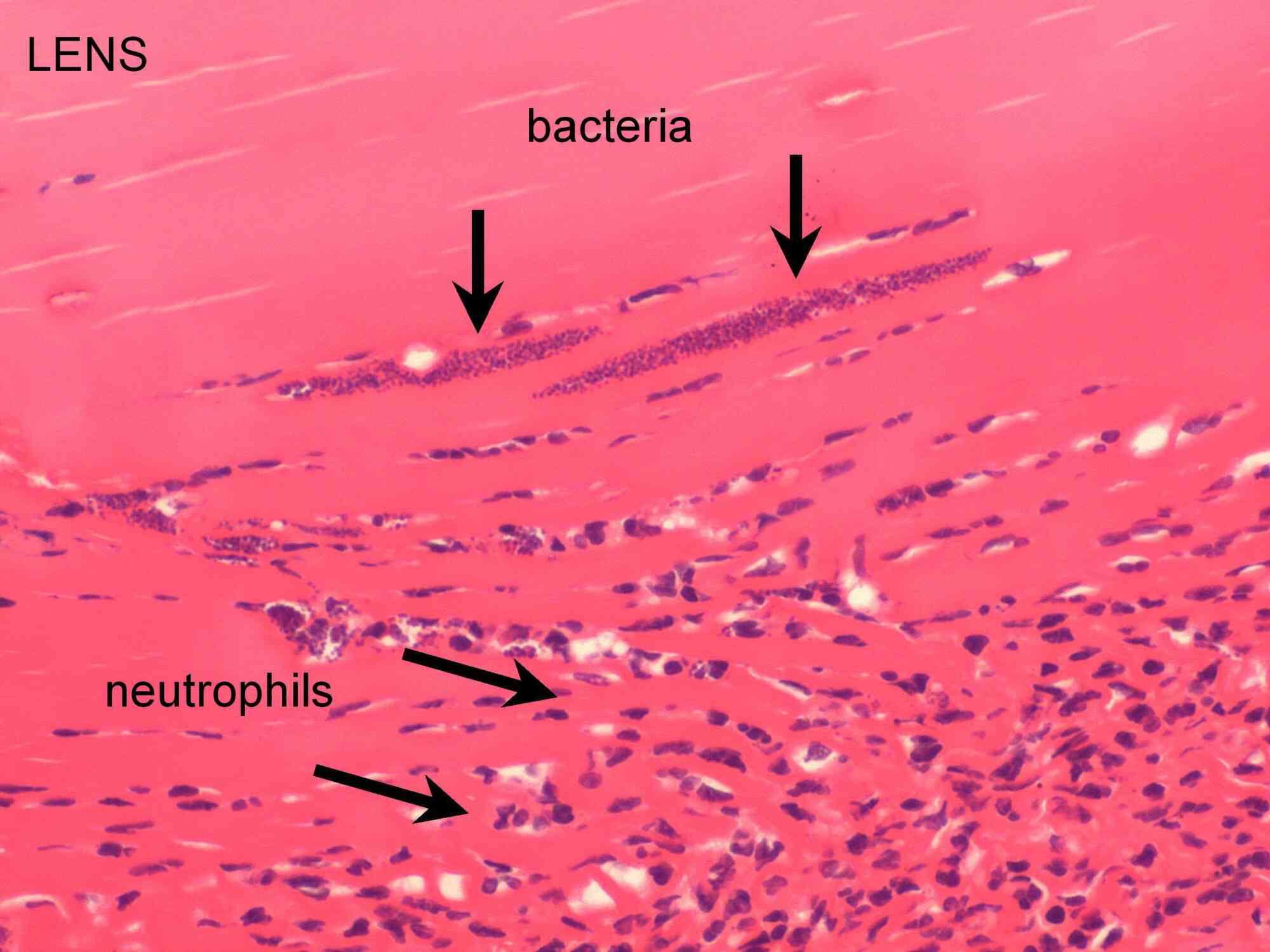 Septic lens implantation syndrome | Case Study | Cytopath