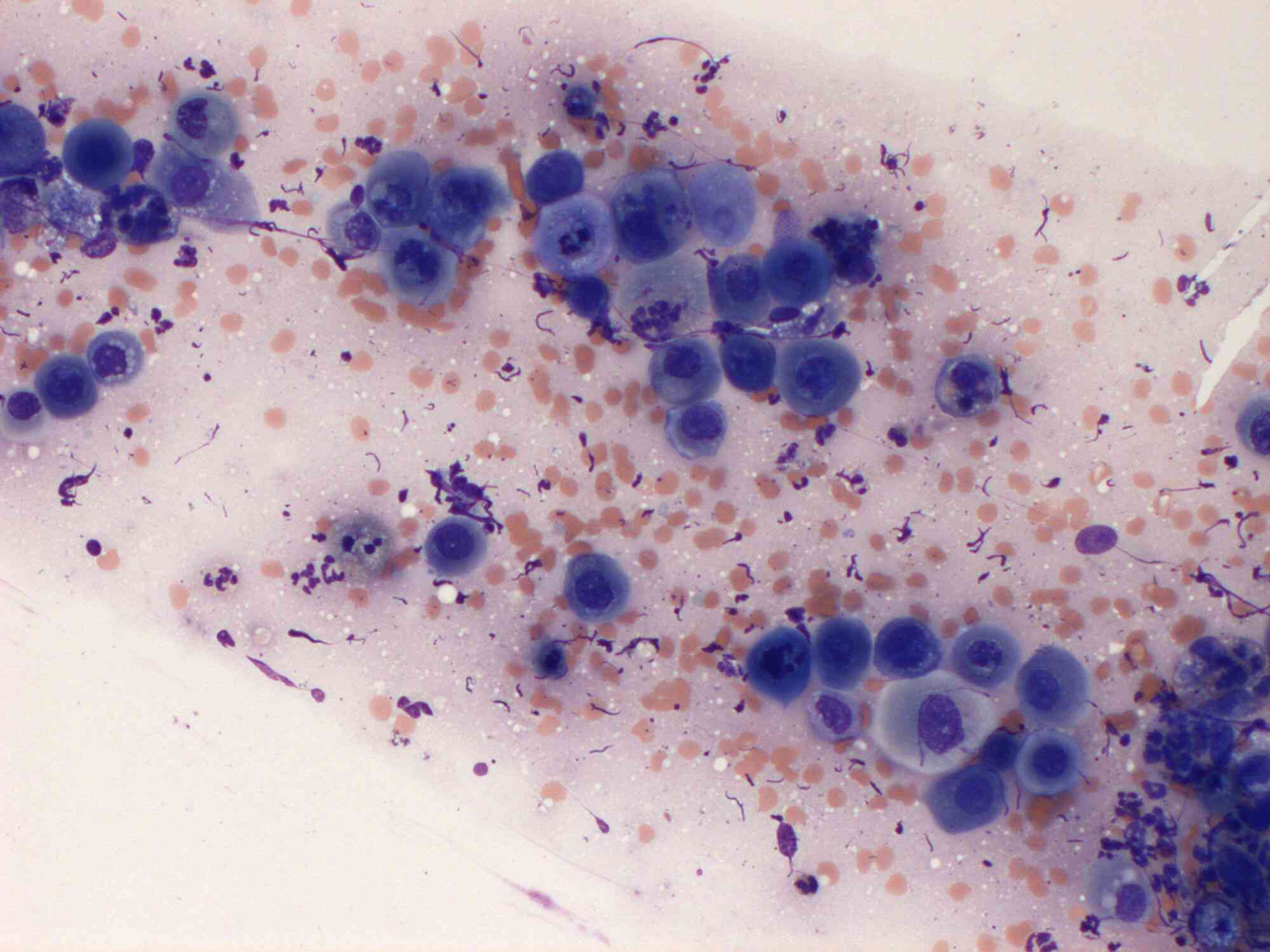 Squamous cell carcinoma in the orbit of a dog | Case Study | Cytopath