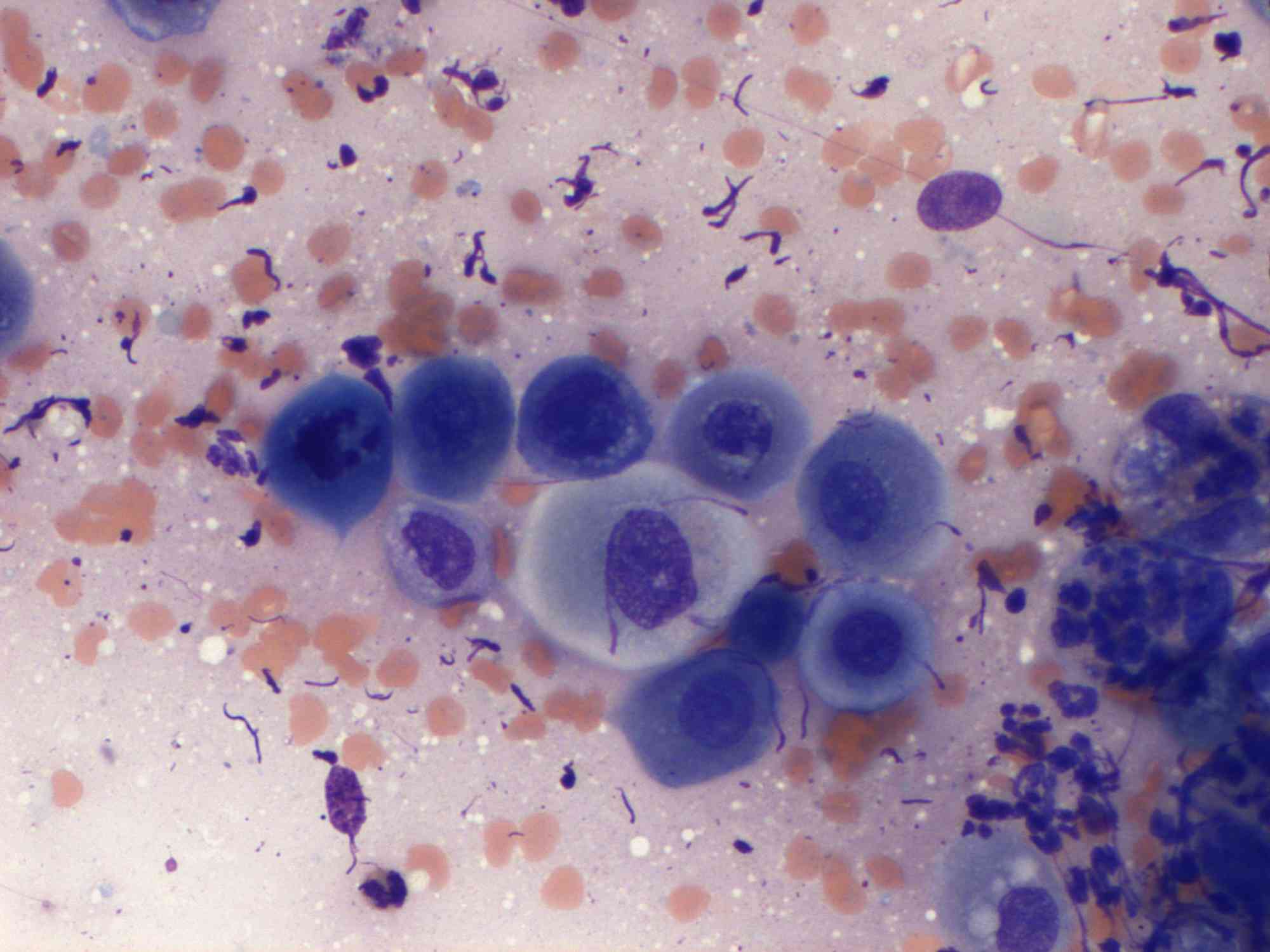 Squamous cell carcinoma in the orbit of a dog | Case Study | Cytopath