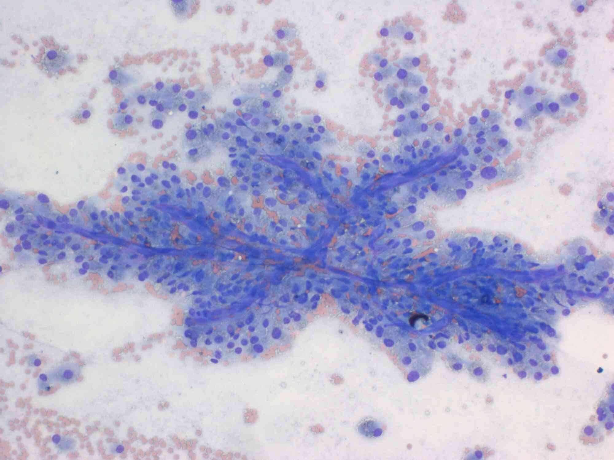 Leydig cell tumour | Case Study | Cytopath