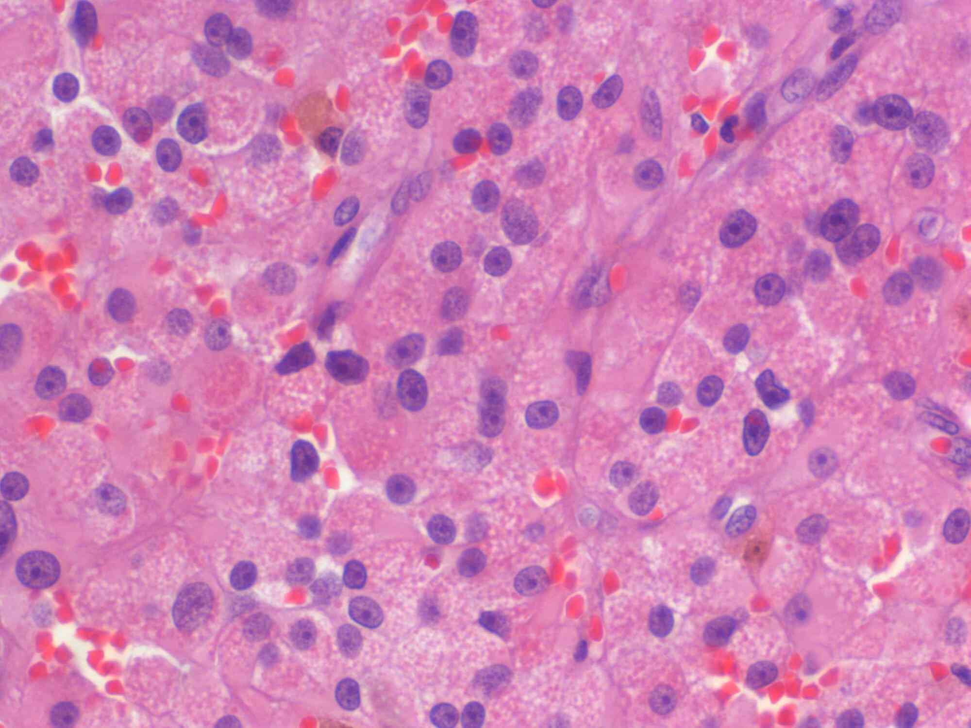 Leydig cell tumour | Case Study | Cytopath