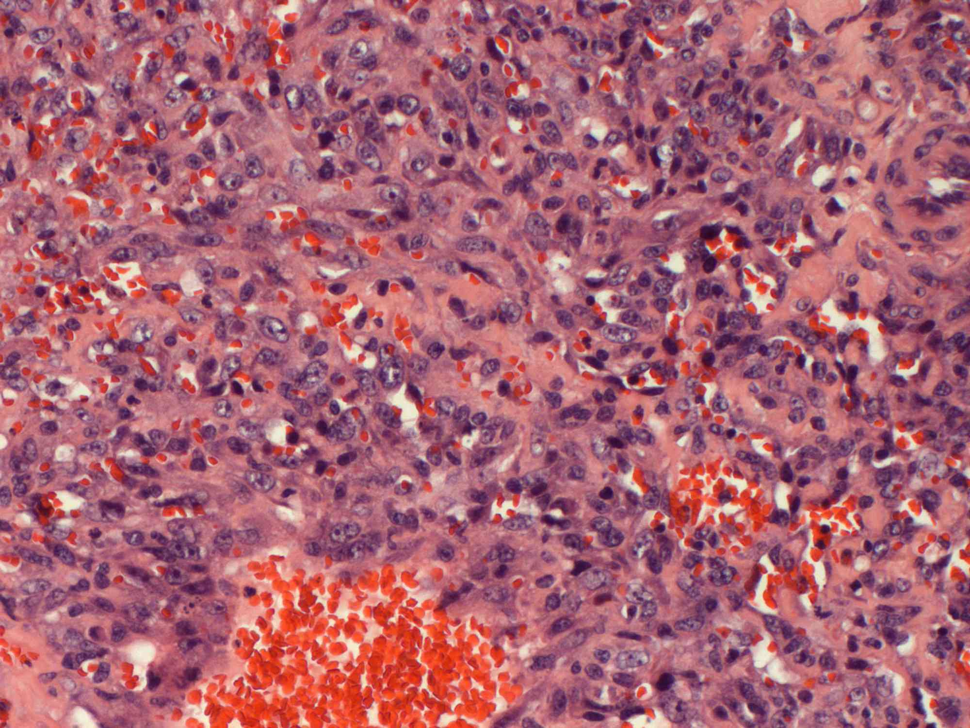 Cutaneous haemangiosarcoma in an elderly dog | Case Study | Cytopath