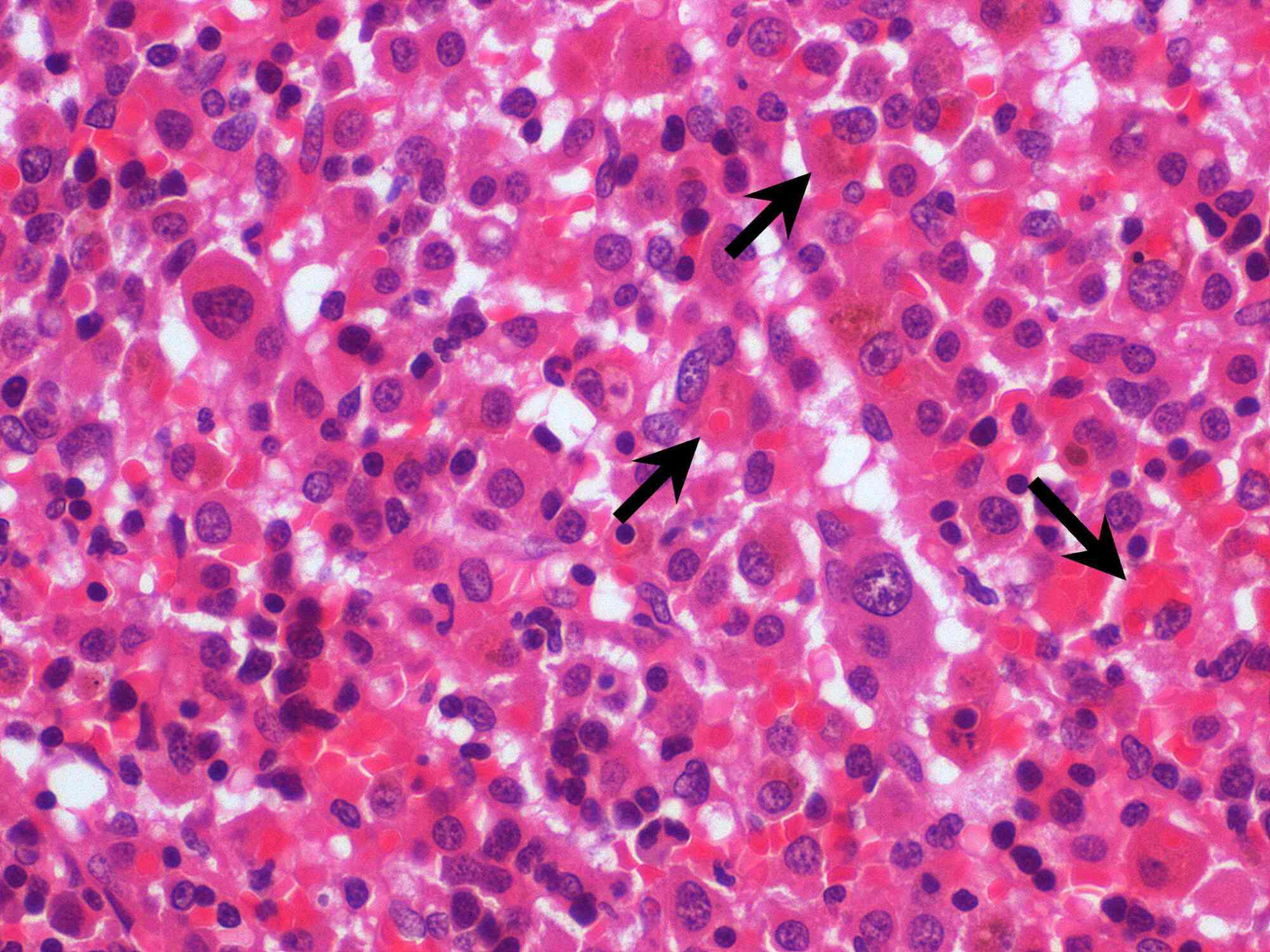 Haemophagocytic histiocytic sarcoma | Case Study | Cytopath