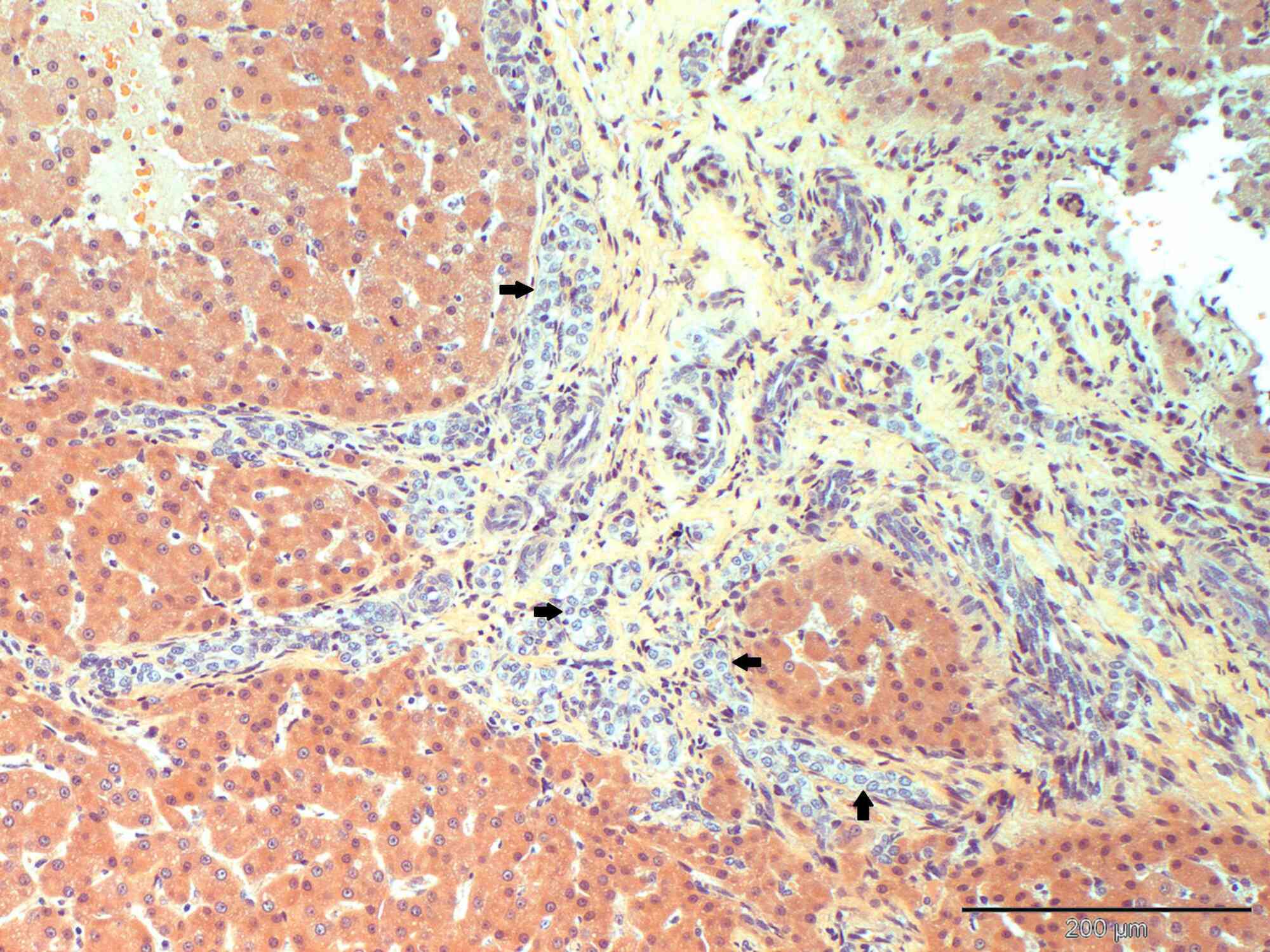 Ductal plate malformation | Case Study | Cytopath