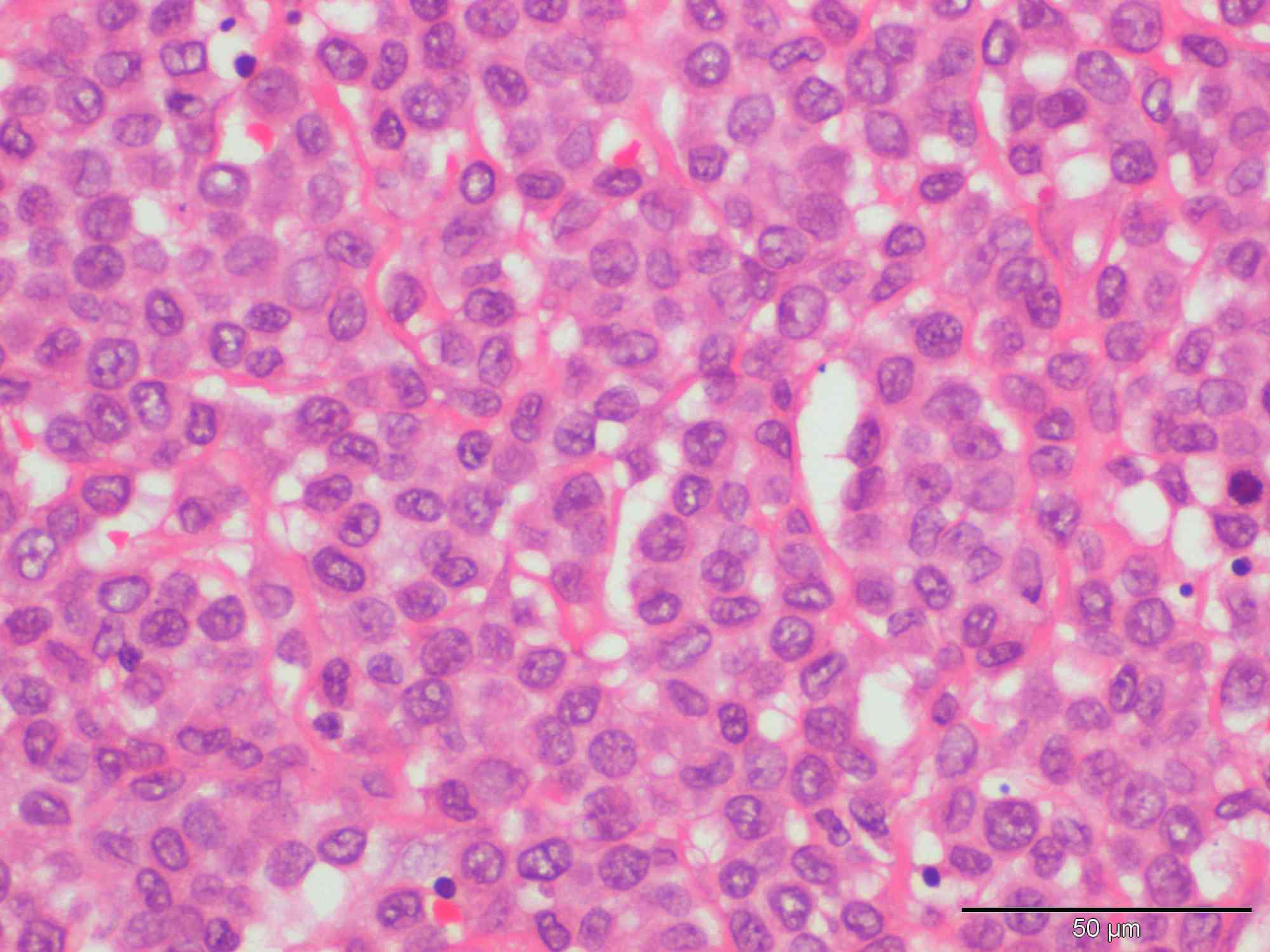 A benign cutaneous histiocytoma in a pug | Case Study | Cytopath