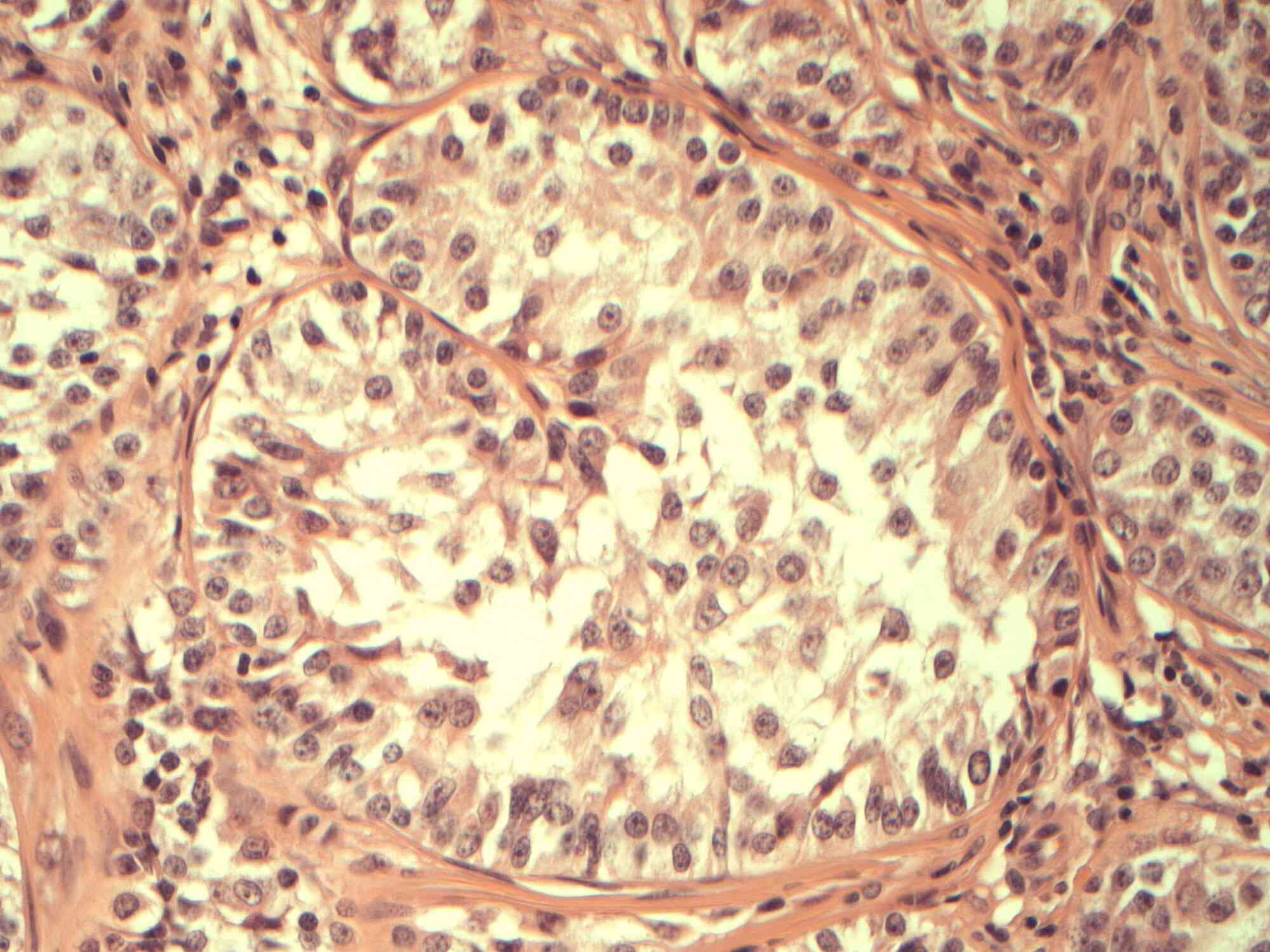 Extratesticular Sertoli cell tumour in a dog | Case Study | Cytopath
