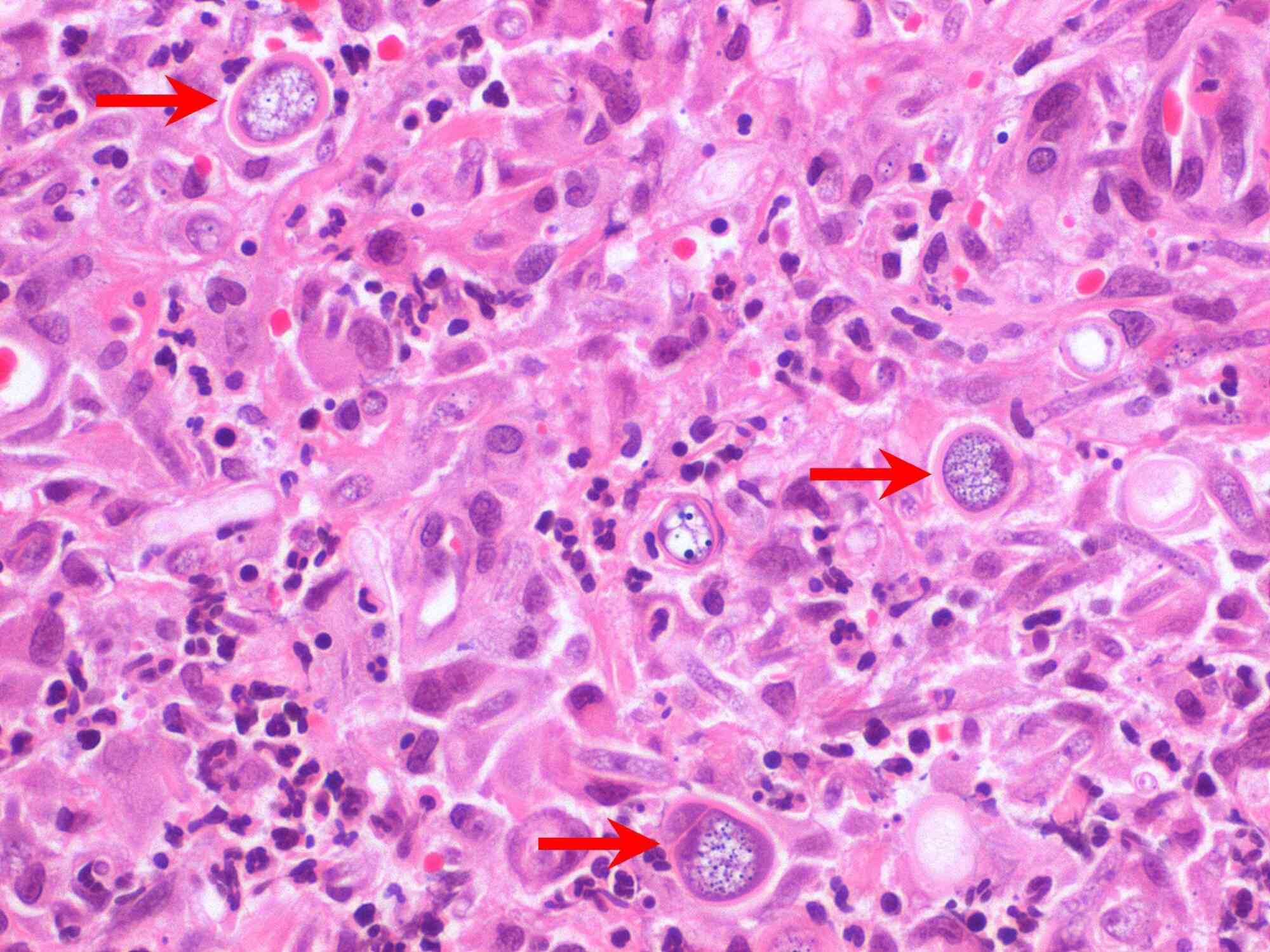 Alternaria spp. infection in an immunocompromised | Case Study | Cytopath