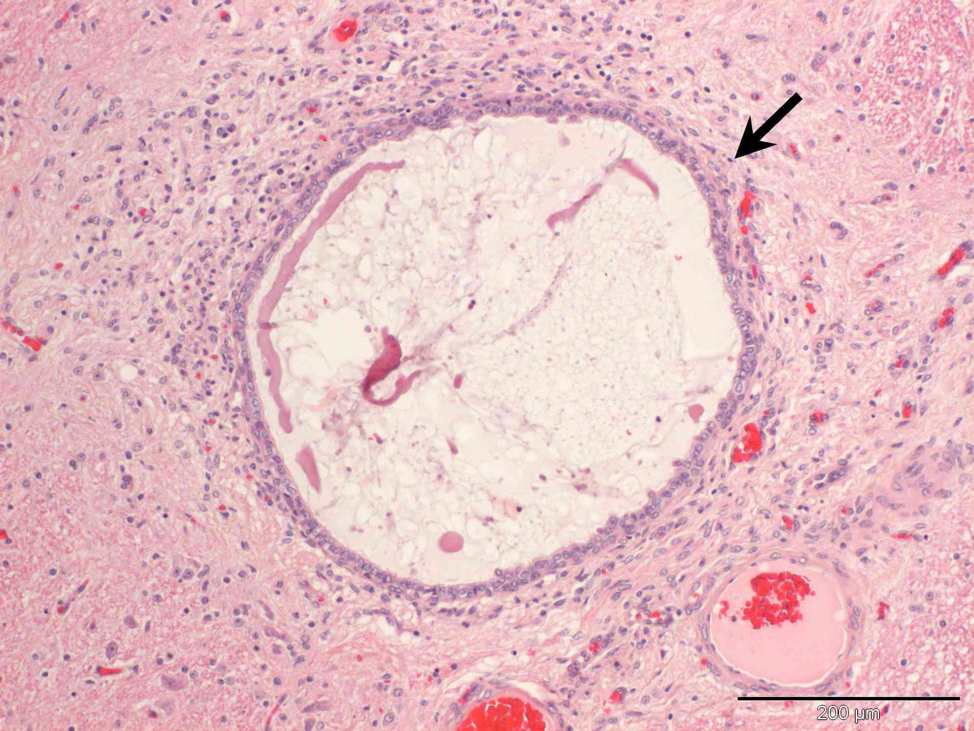 Ovarian teratoma | Case Study | Cytopath