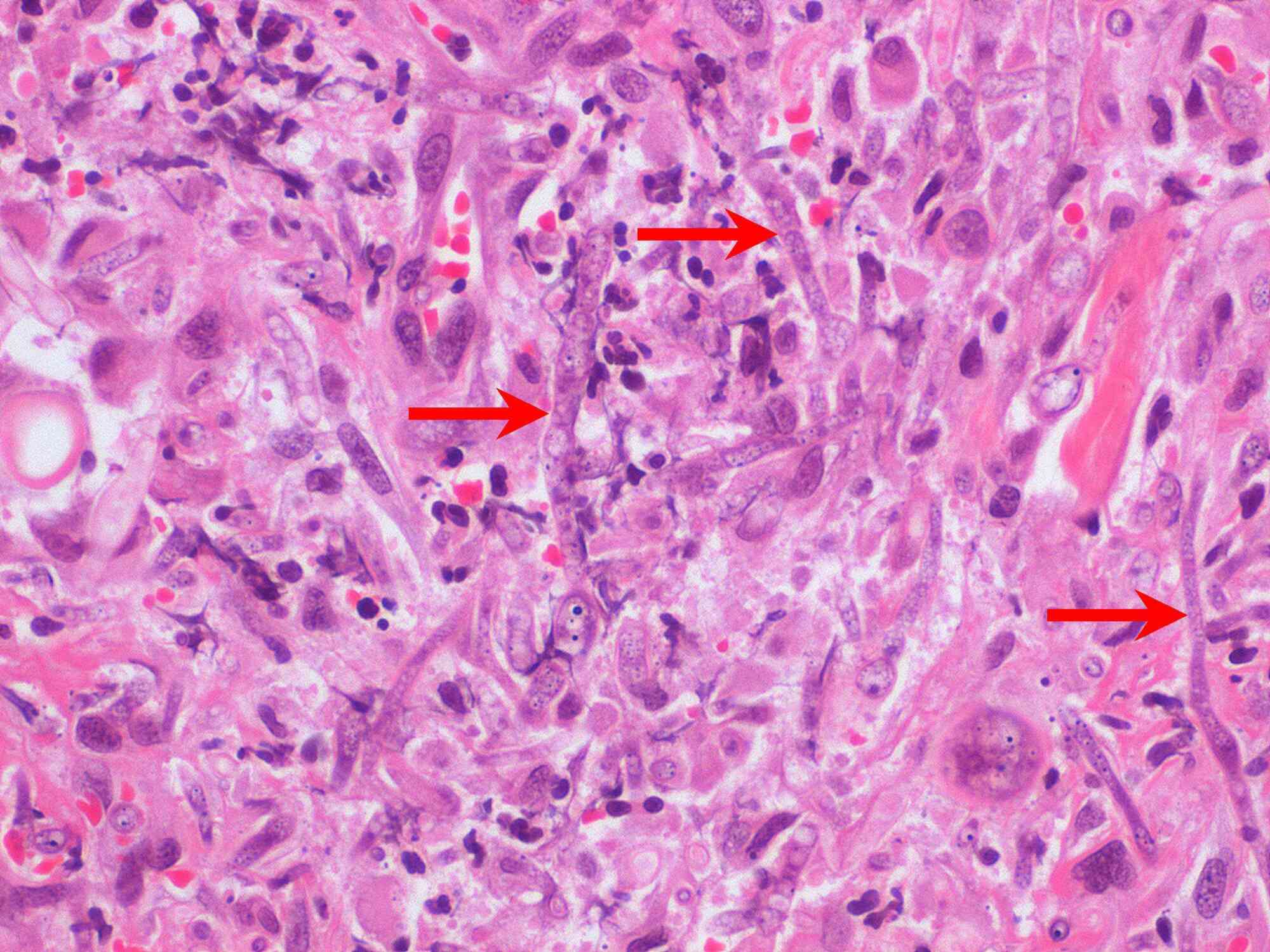 Alternaria spp. infection in an immunocompromised | Case Study | Cytopath
