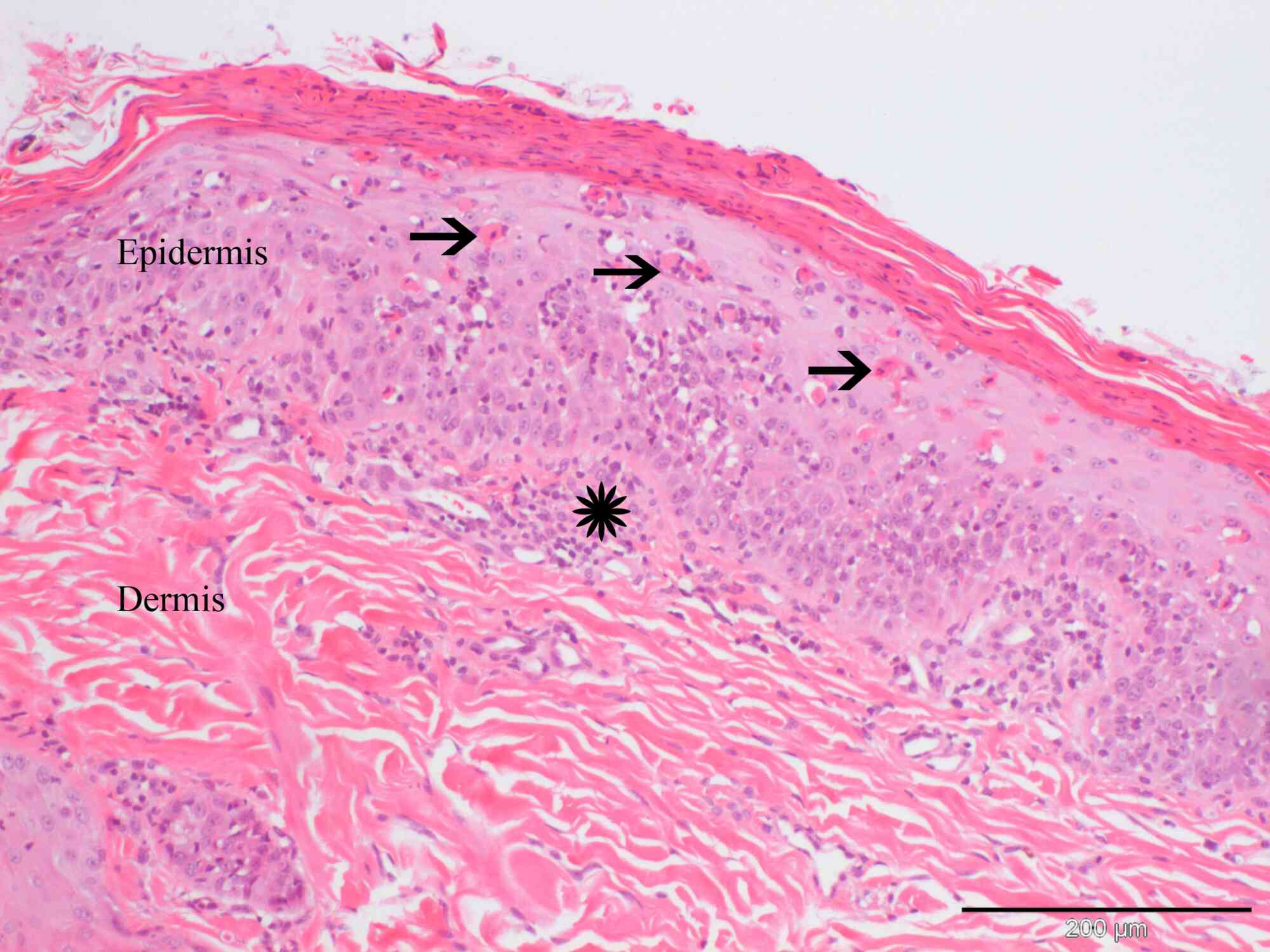 Histologia Eritema Multiforme
