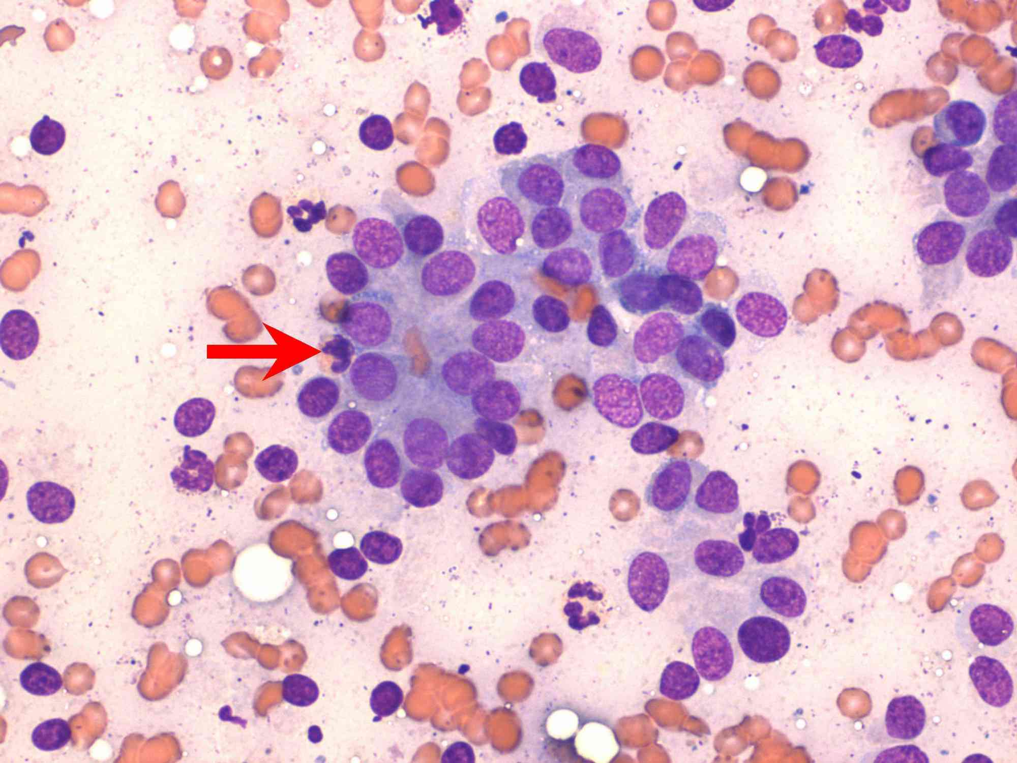 An enlarged sublumbar lymph node in a hypercalcaem | Case Study | Cytopath