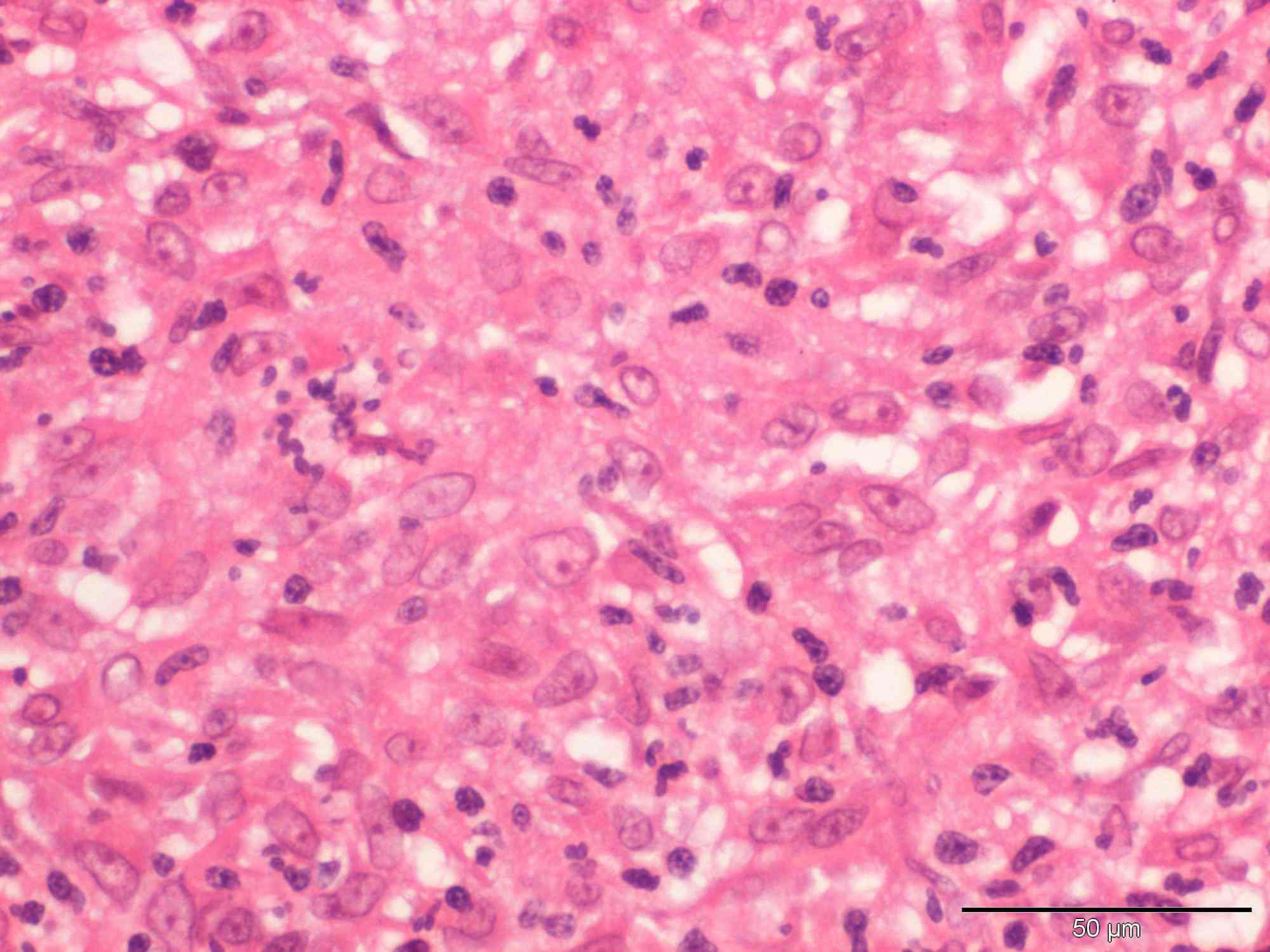 Mycobacterial infection in an eye | Case Study | Cytopath