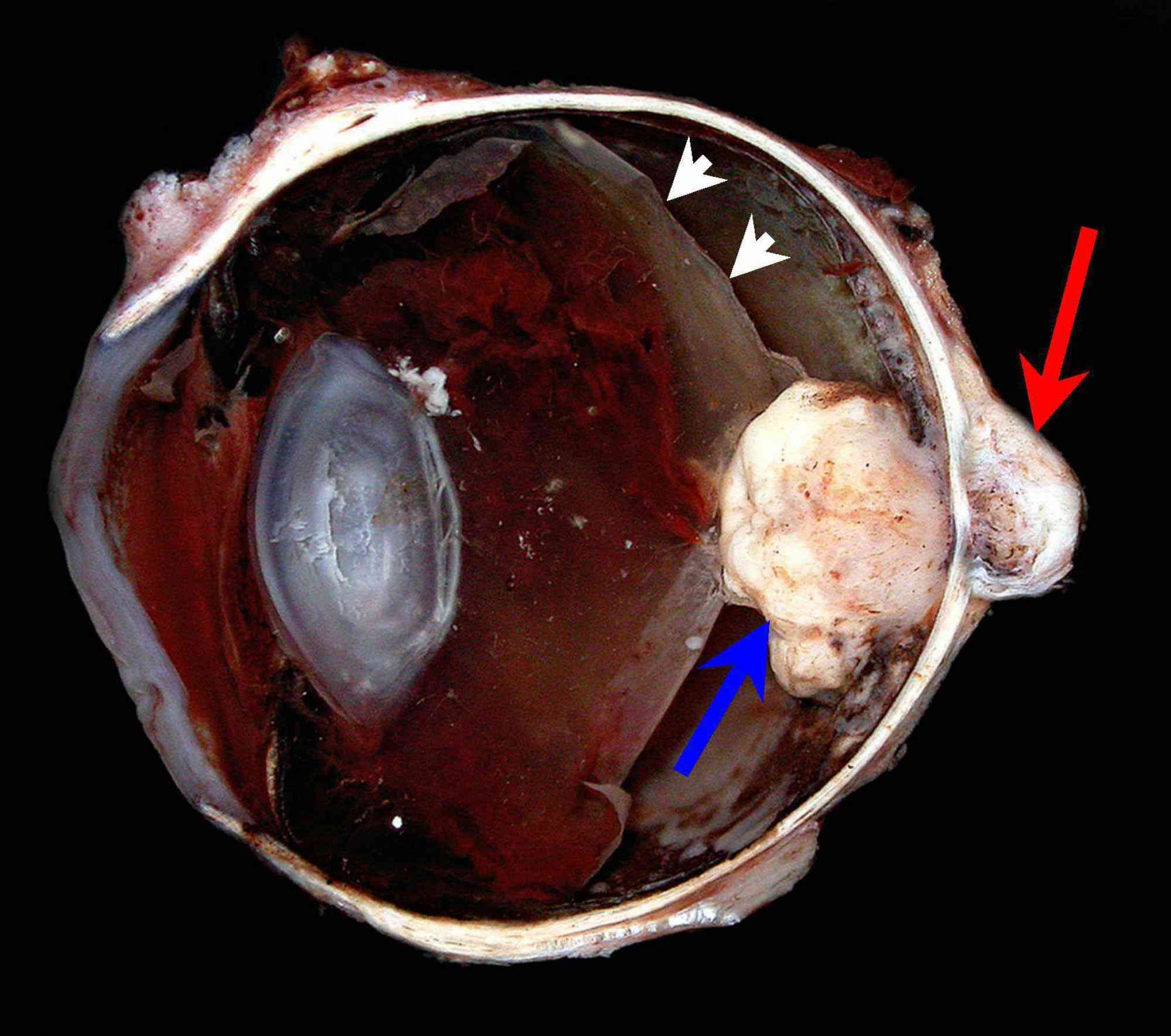 Optic nerve glioma a dog | Case Study | Cytopath