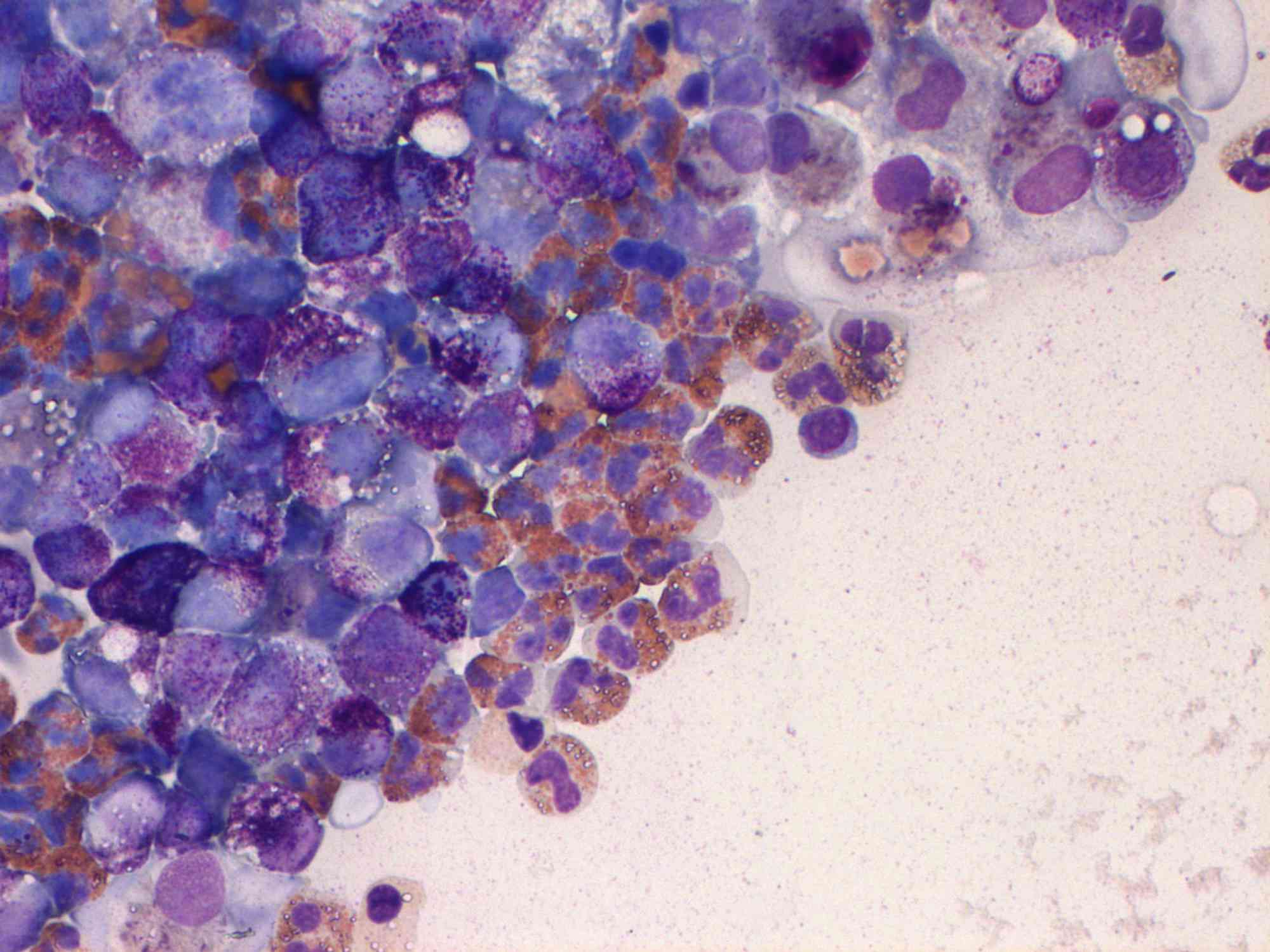 Neoplastic pleural effusion in a dog | Case Study | Cytopath