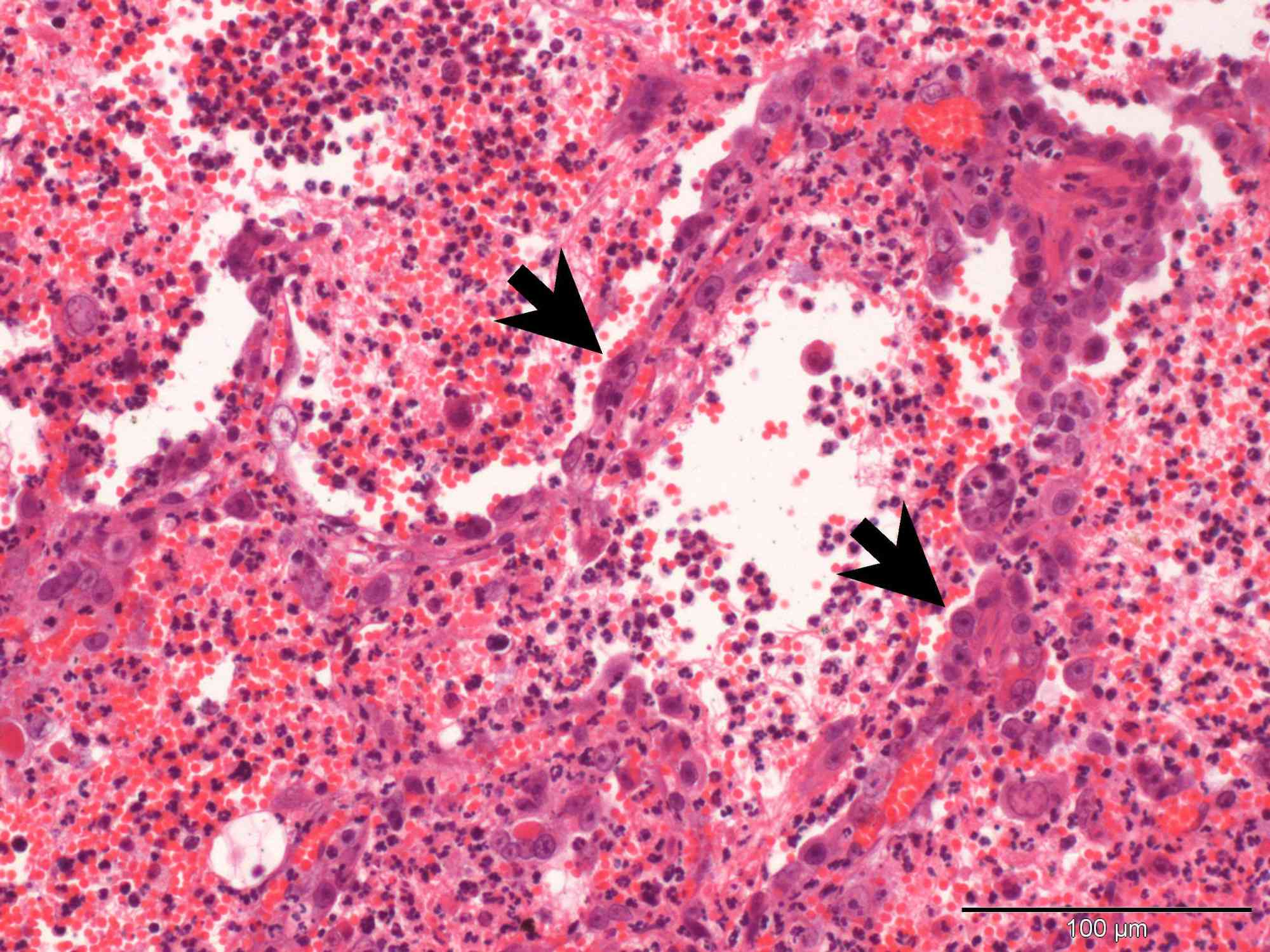 Autumn has arrived - fatal cowpox infection in a c | Case Study | Cytopath