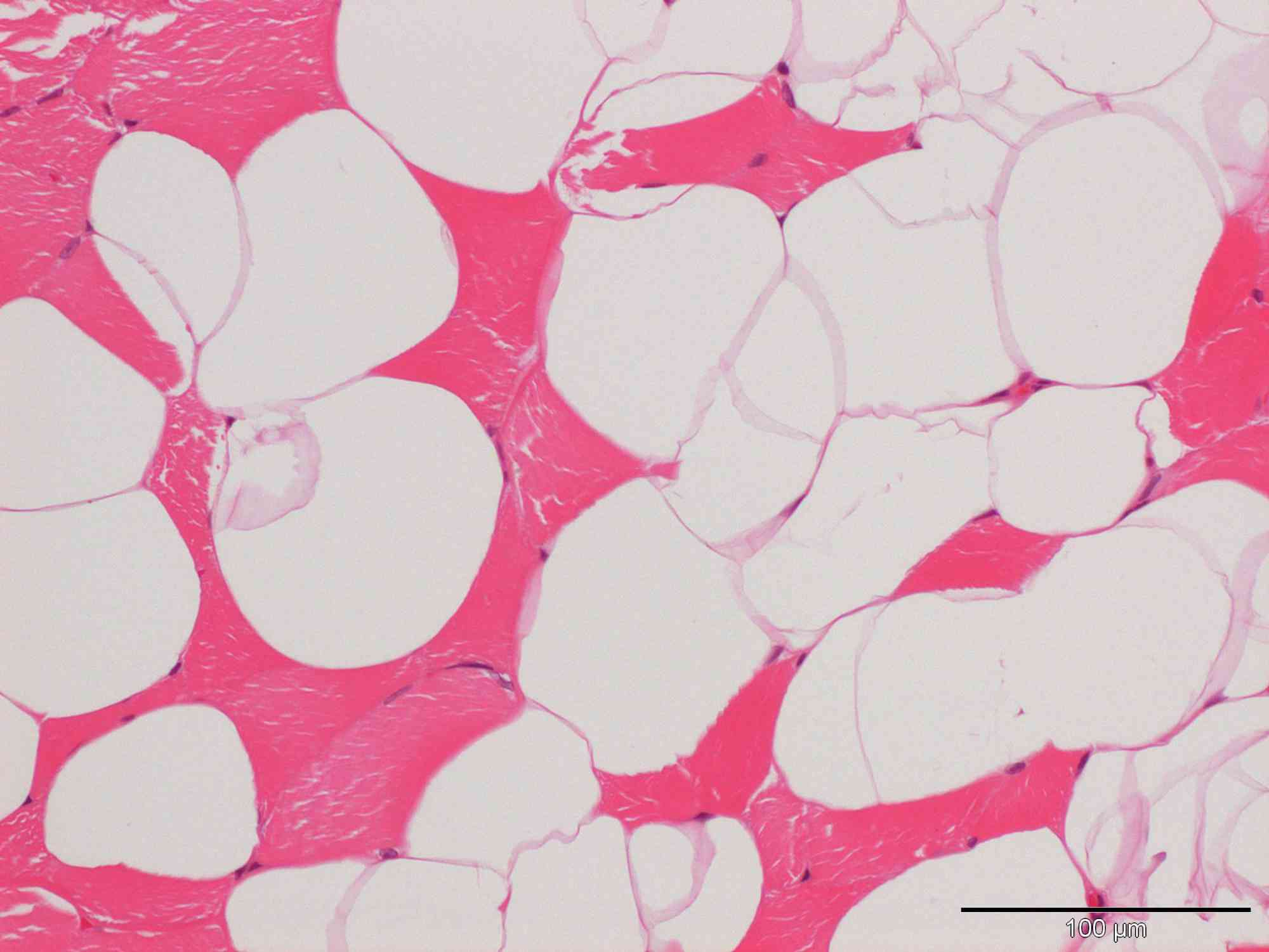 A cutaneous infiltrative lipoma in a 6-year-old fe | Case Study | Cytopath
