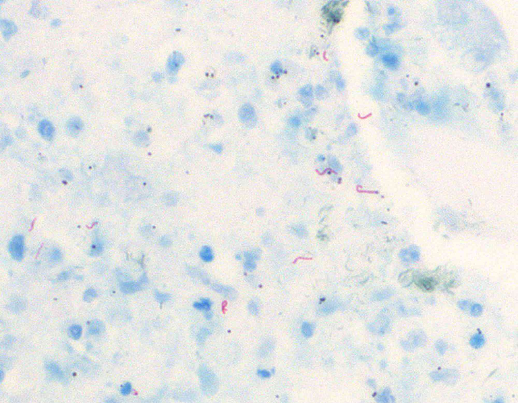 Mycobacterial infection in an eye | Case Study | Cytopath