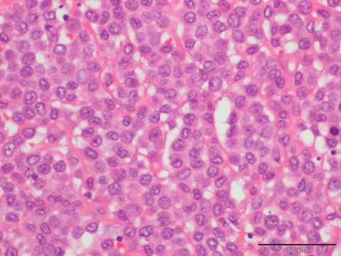 A benign cutaneous histiocytoma in a pug | Case Study | Cytopath