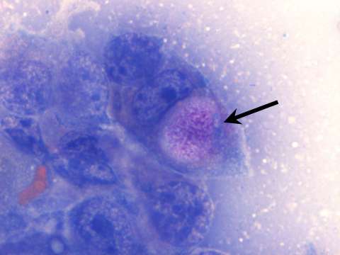 Transitional cell carcinoma (TCC) in a dog | Case Study | Cytopath