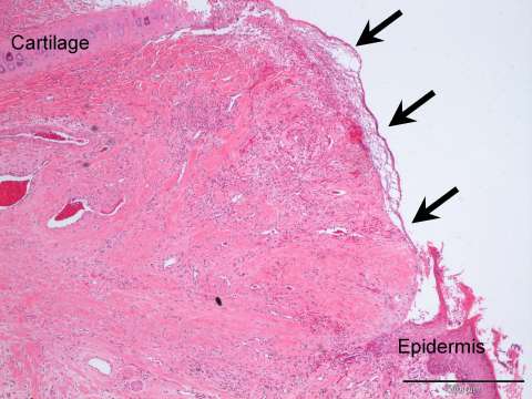 Proliferative thrombovascular necrosis of the pinn | Case Study | Cytopath