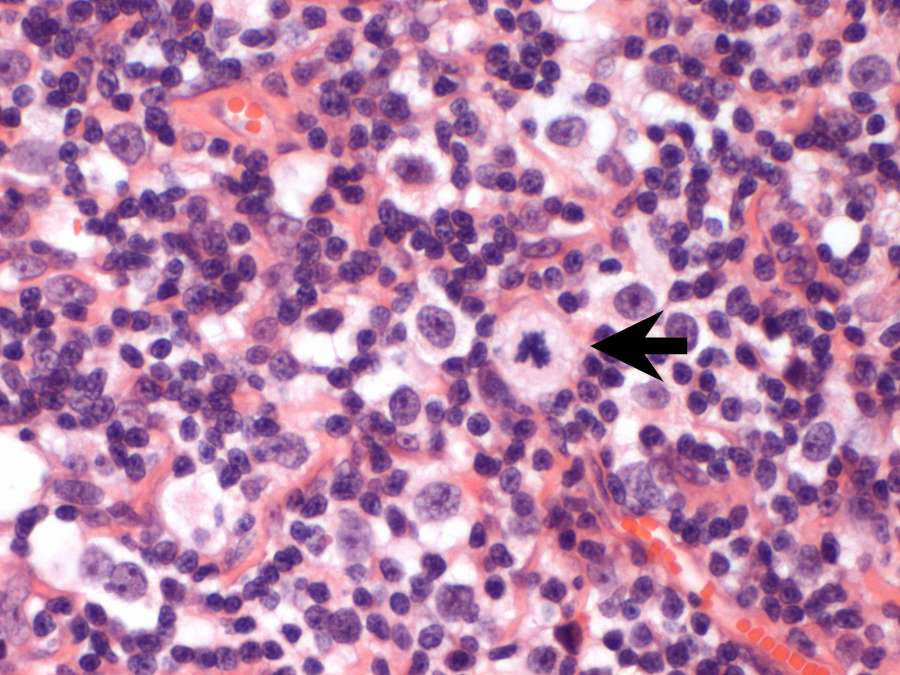 Hodgkin's-like lymphoma in a cat | Case Study | Cytopath