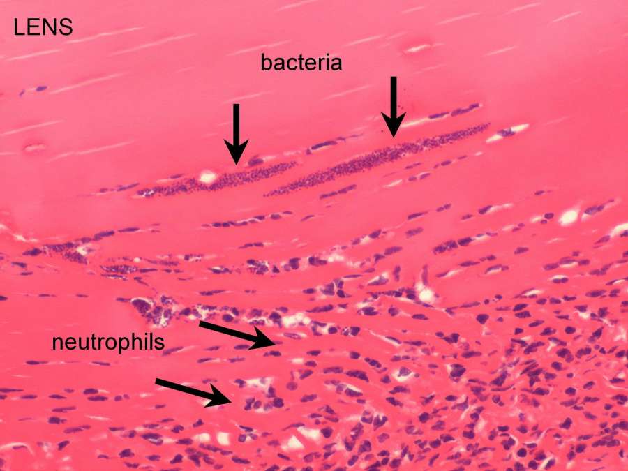 Septic lens implantation syndrome | Case Study | Cytopath