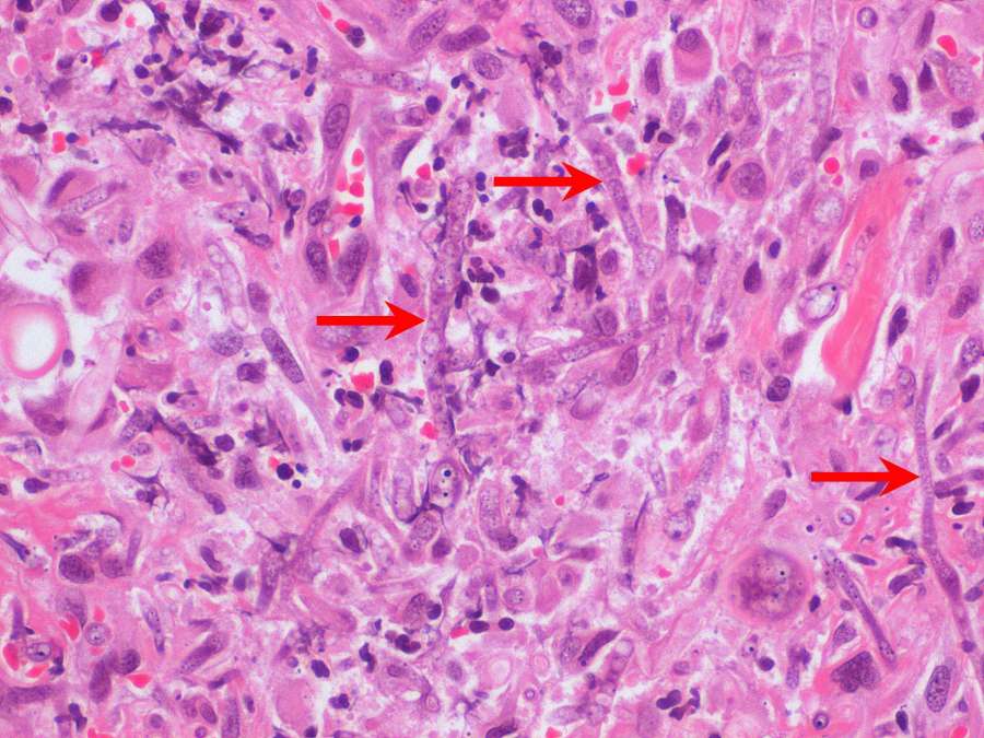 Alternaria spp. infection in an immunocompromised | Case Study | Cytopath