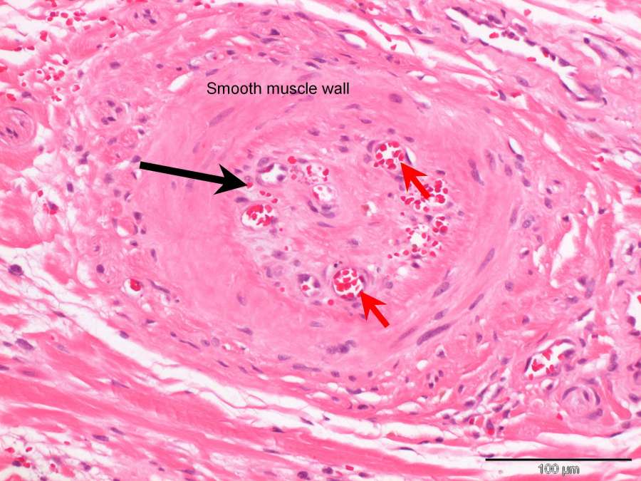 Proliferative thrombovascular necrosis of the pinn | Case Study | Cytopath