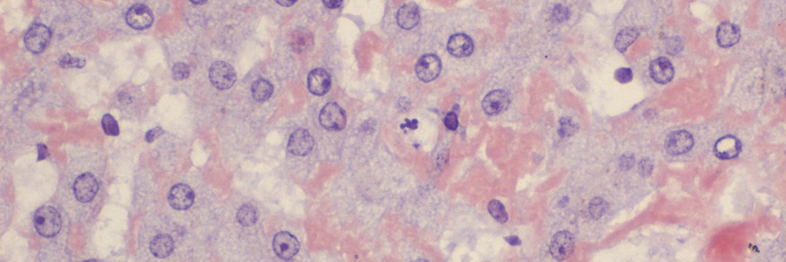 Transitional cell carcinoma (TCC) in a dog | Case Study | Cytopath