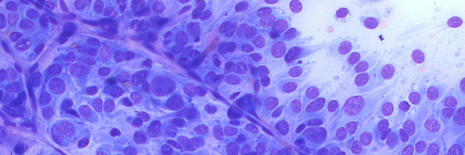 Transitional cell carcinoma (TCC) in a dog | Case Study | Cytopath